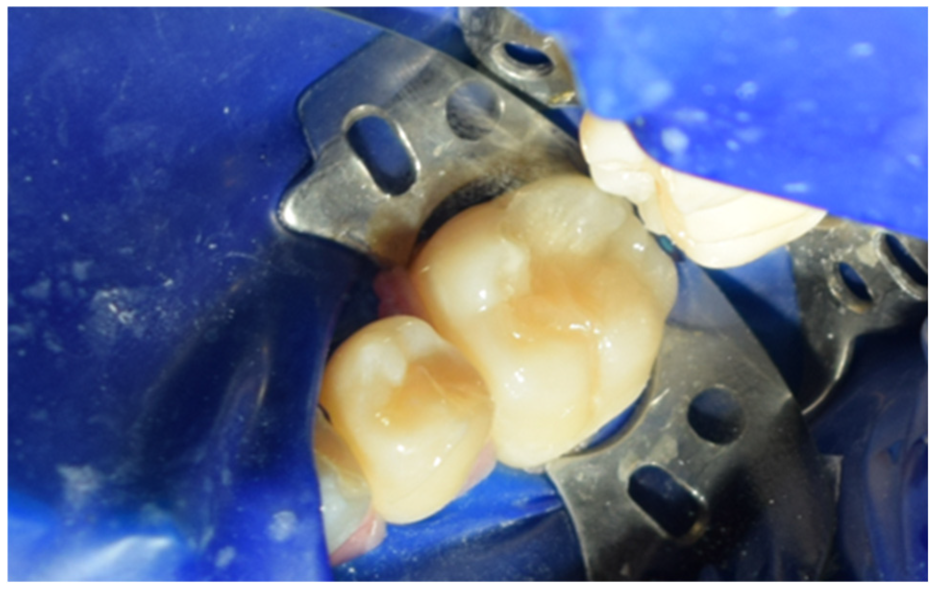 Direct and Semi-Direct Composite Techniques in Posterior Teeth: A Two ...