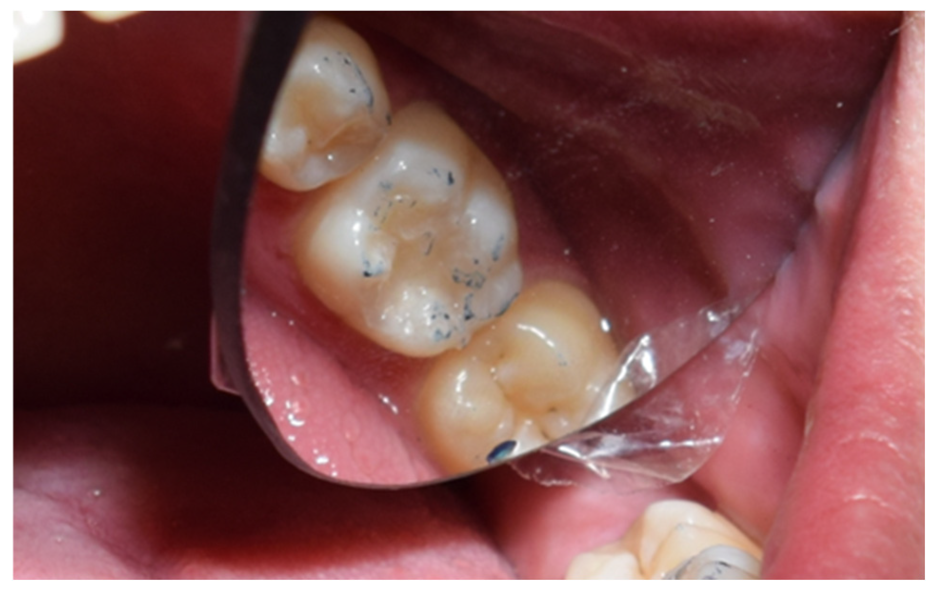 Direct and Semi-Direct Composite Techniques in Posterior Teeth: A Two ...