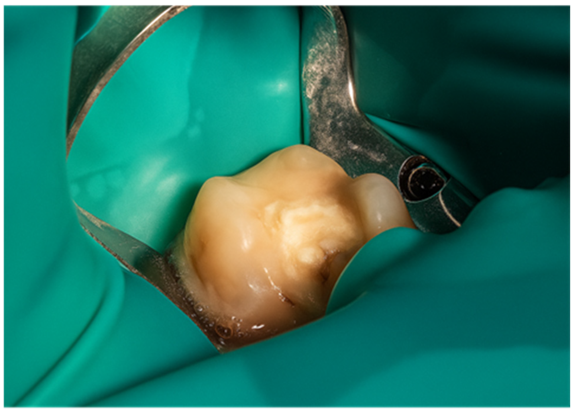 Direct and Semi-Direct Composite Techniques in Posterior Teeth: A Two ...