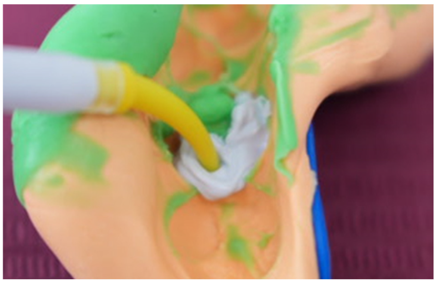 Direct and Semi-Direct Composite Techniques in Posterior Teeth: A Two ...