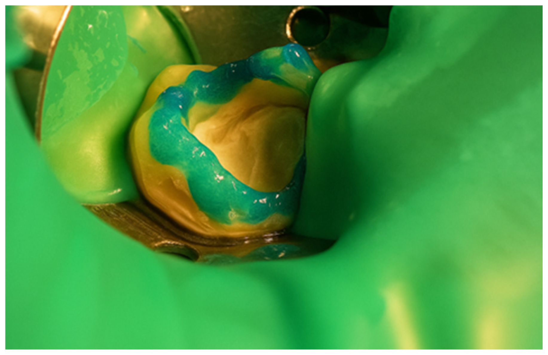 Direct and Semi-Direct Composite Techniques in Posterior Teeth: A Two ...