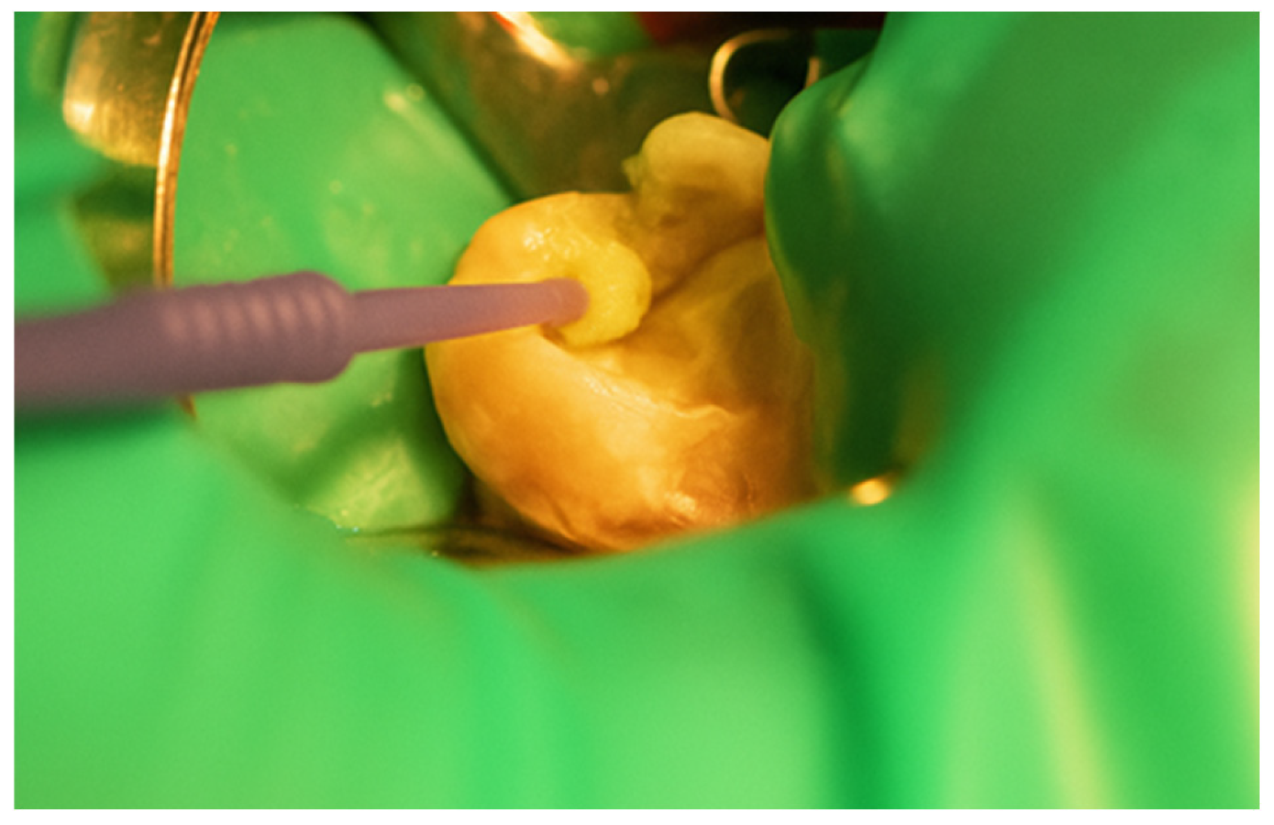 Direct and Semi-Direct Composite Techniques in Posterior Teeth: A Two ...