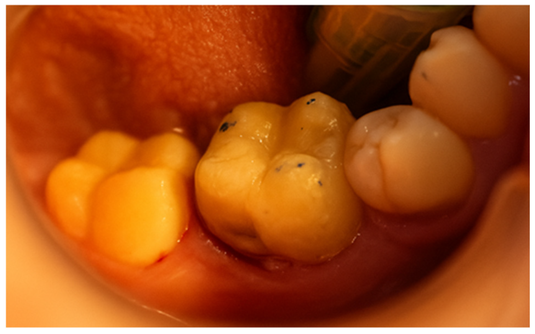 Direct and Semi-Direct Composite Techniques in Posterior Teeth: A Two ...