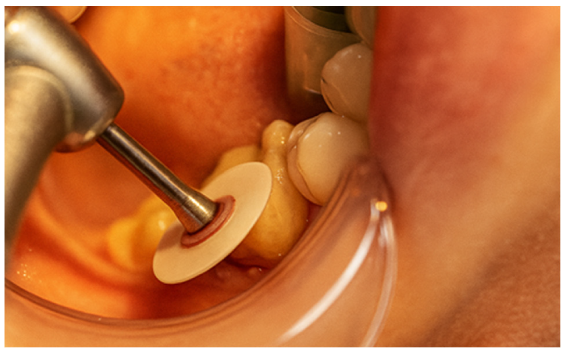 Direct and Semi-Direct Composite Techniques in Posterior Teeth: A Two ...
