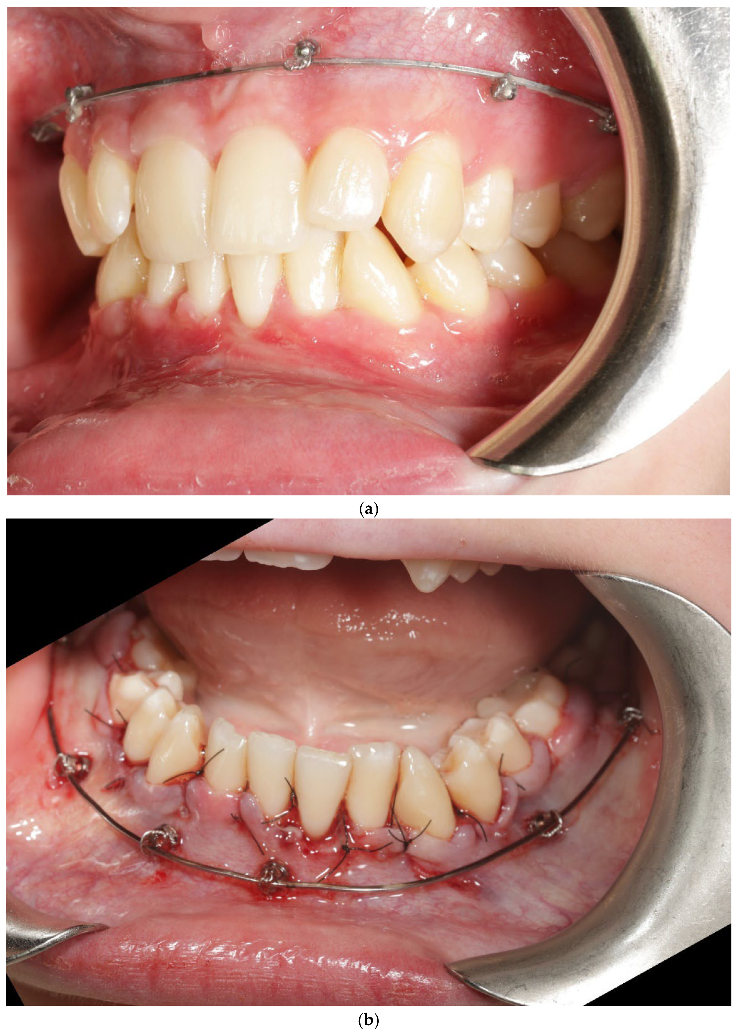 Clinical Soft Tissue Adaptation to Biomechanical Modulation with the ...