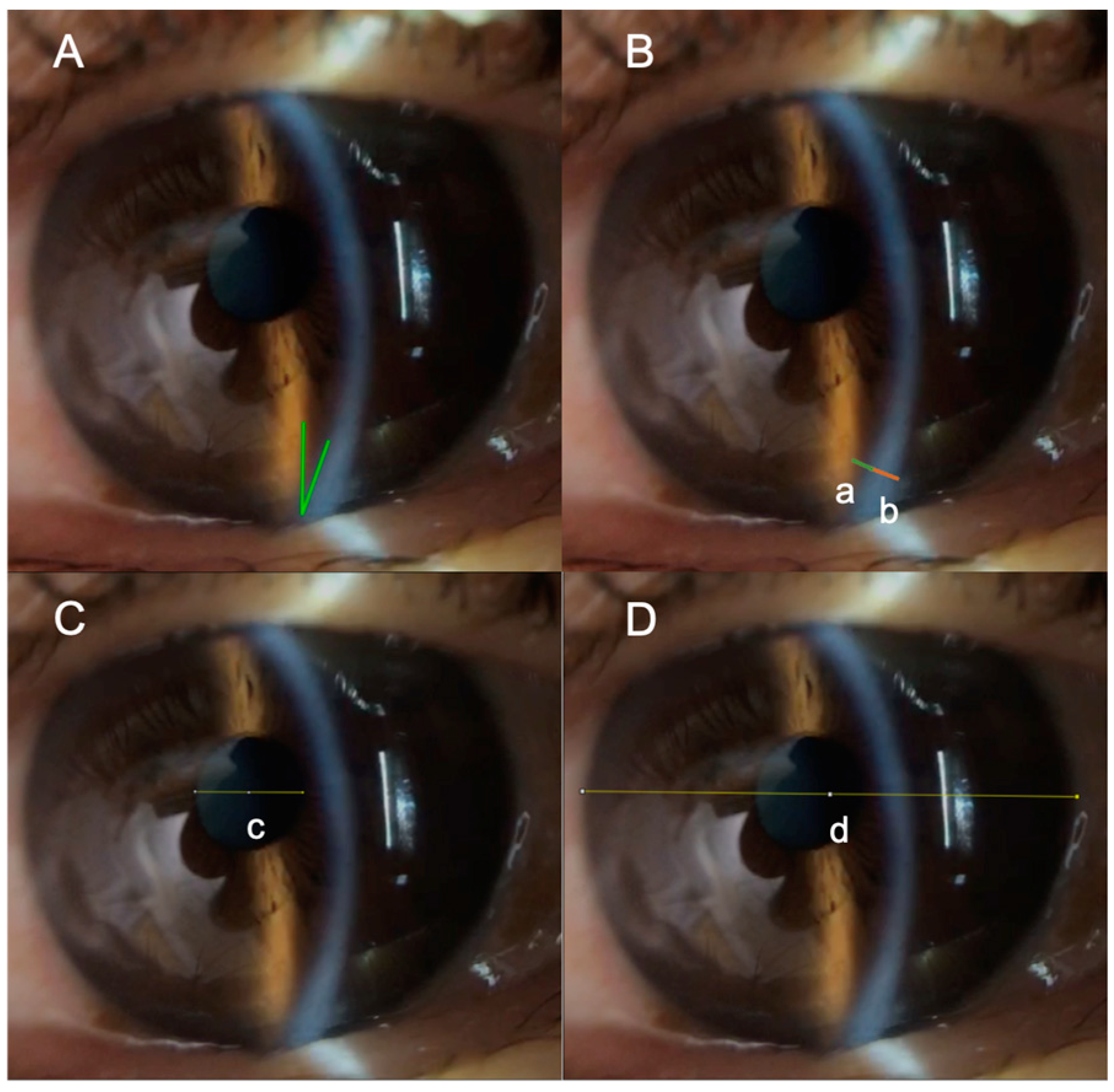 Prospective Evaluation of Ocular Anterior Segment Morphology Changes in ...