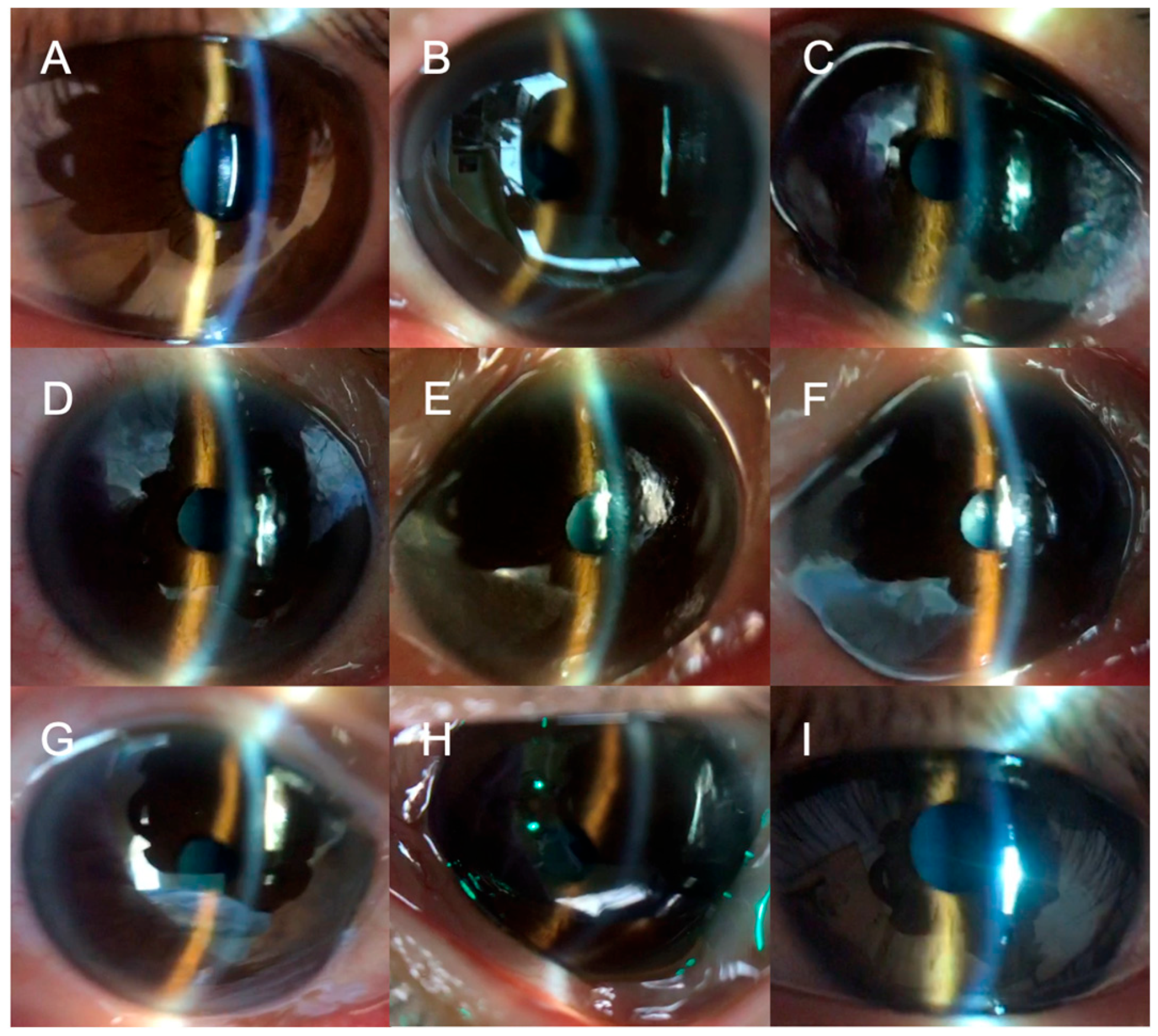 Prospective Evaluation of Ocular Anterior Segment Morphology Changes in ...