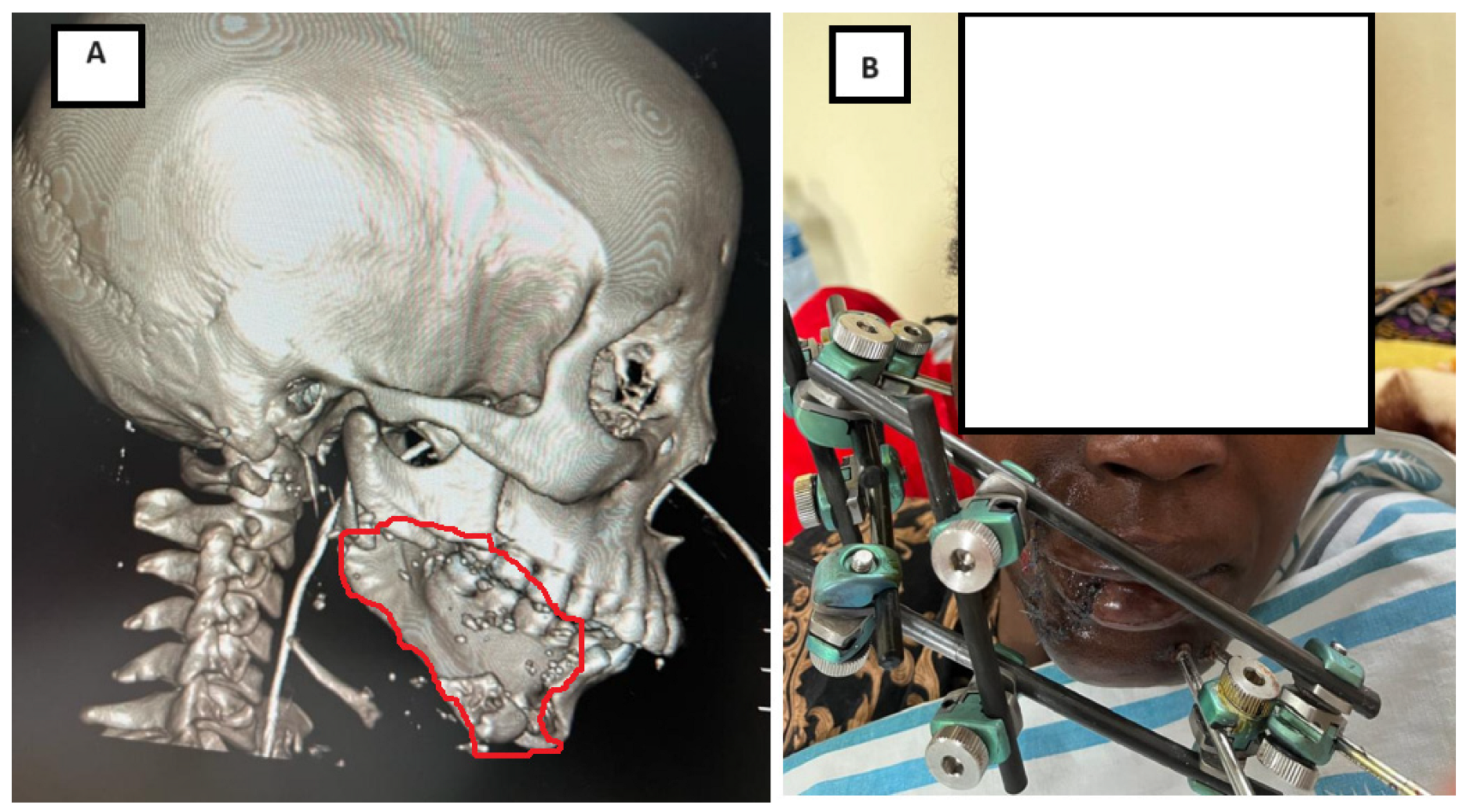 External Fixation for War-Related Mandibular Fractures in a Resource-Limited Setting: A ...
