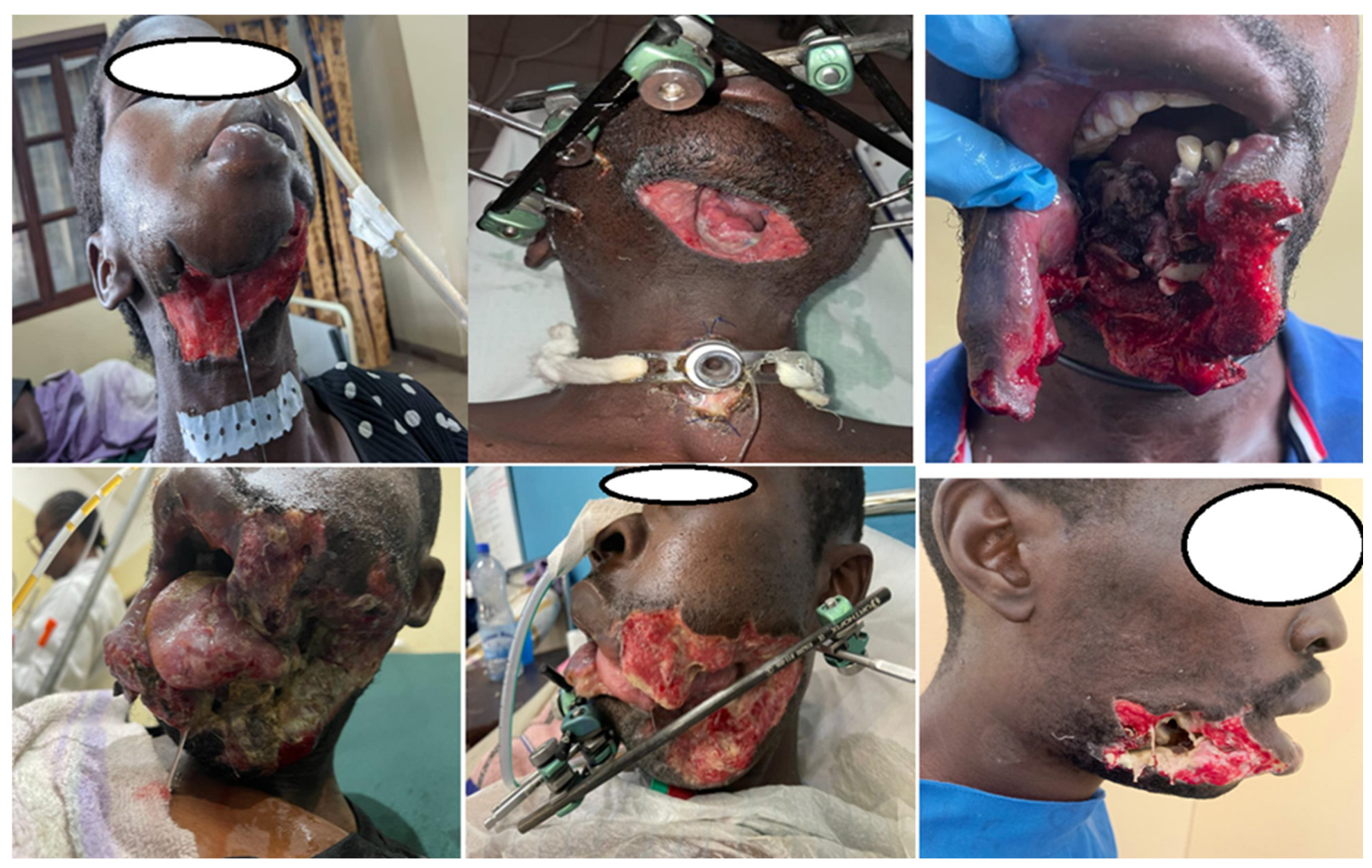 External Fixation for War-Related Mandibular Fractures in a Resource-Limited Setting: A ...