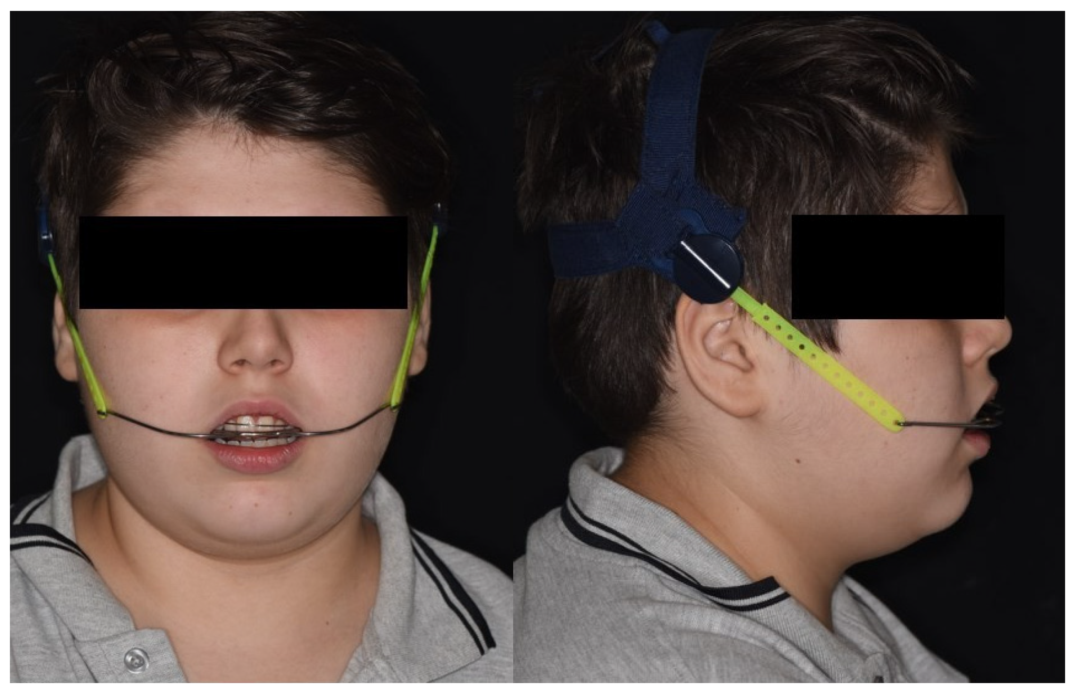 Evaluation of an Elastodontic Bioactivator Versus High-Pull Headgear ...