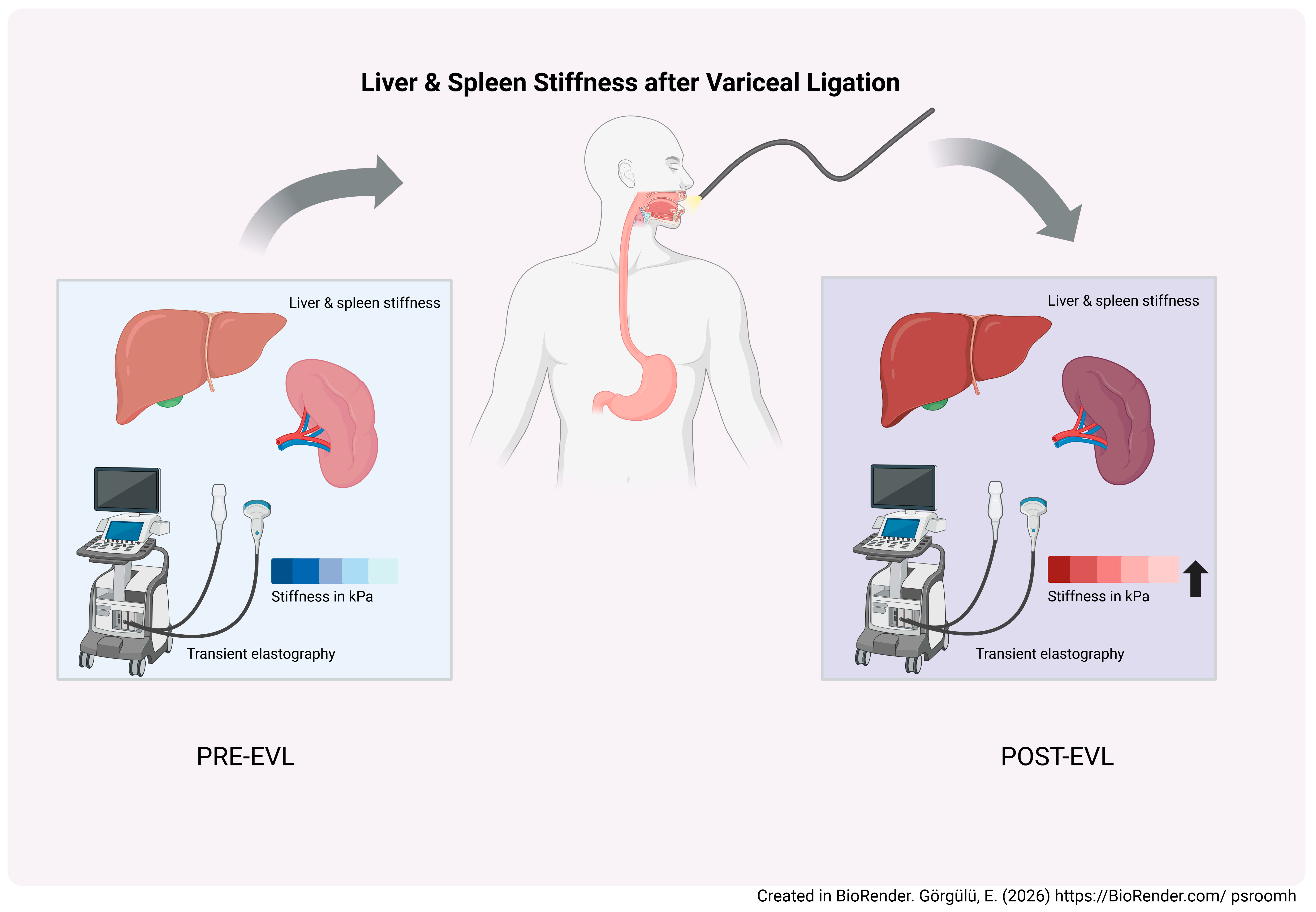 Acute Changes in Liver and Spleen Stiffness Following Endoscopic ...