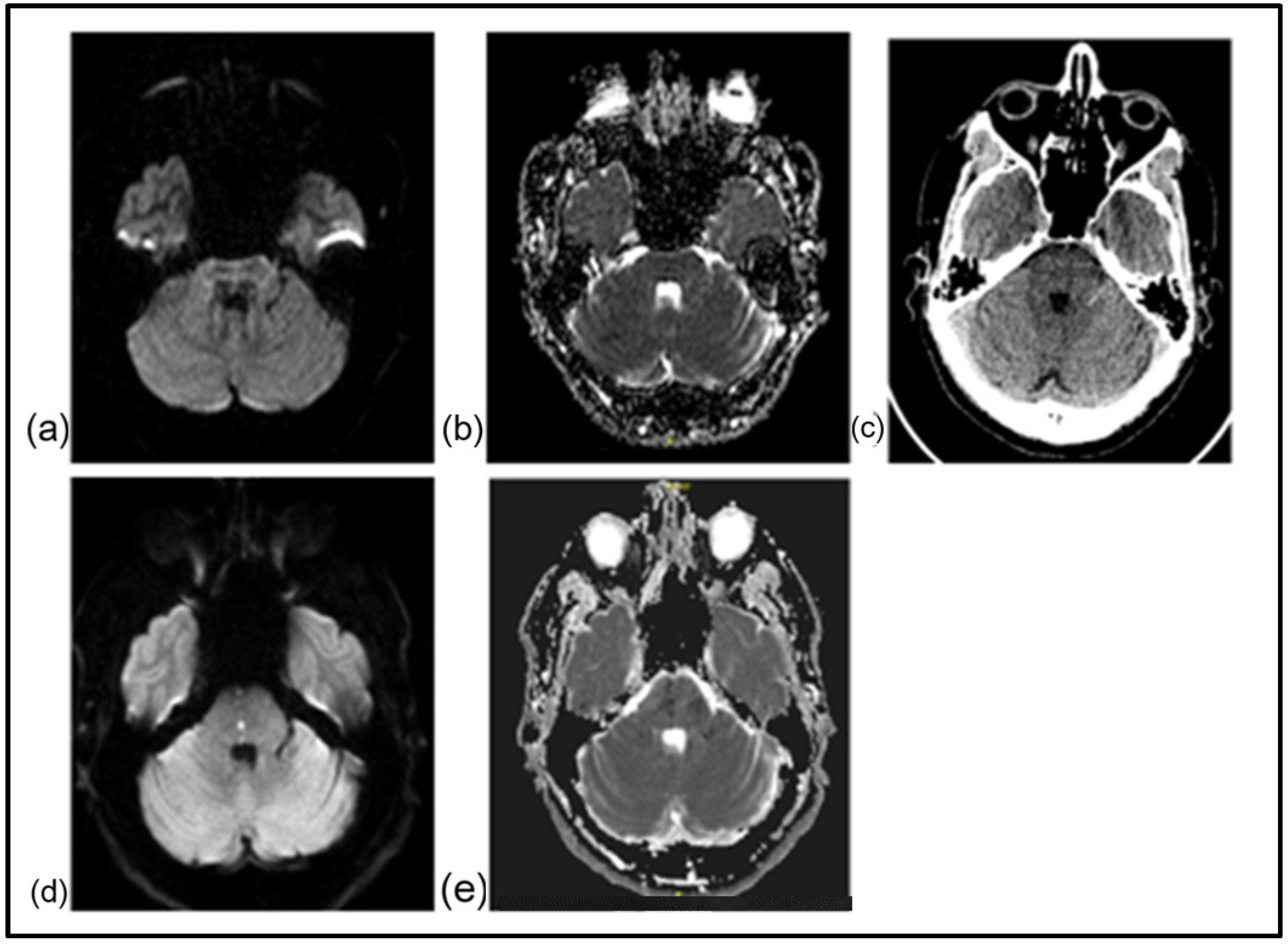 Limitations and Blind Spots of Diffusion-Weighted Imaging in the ...