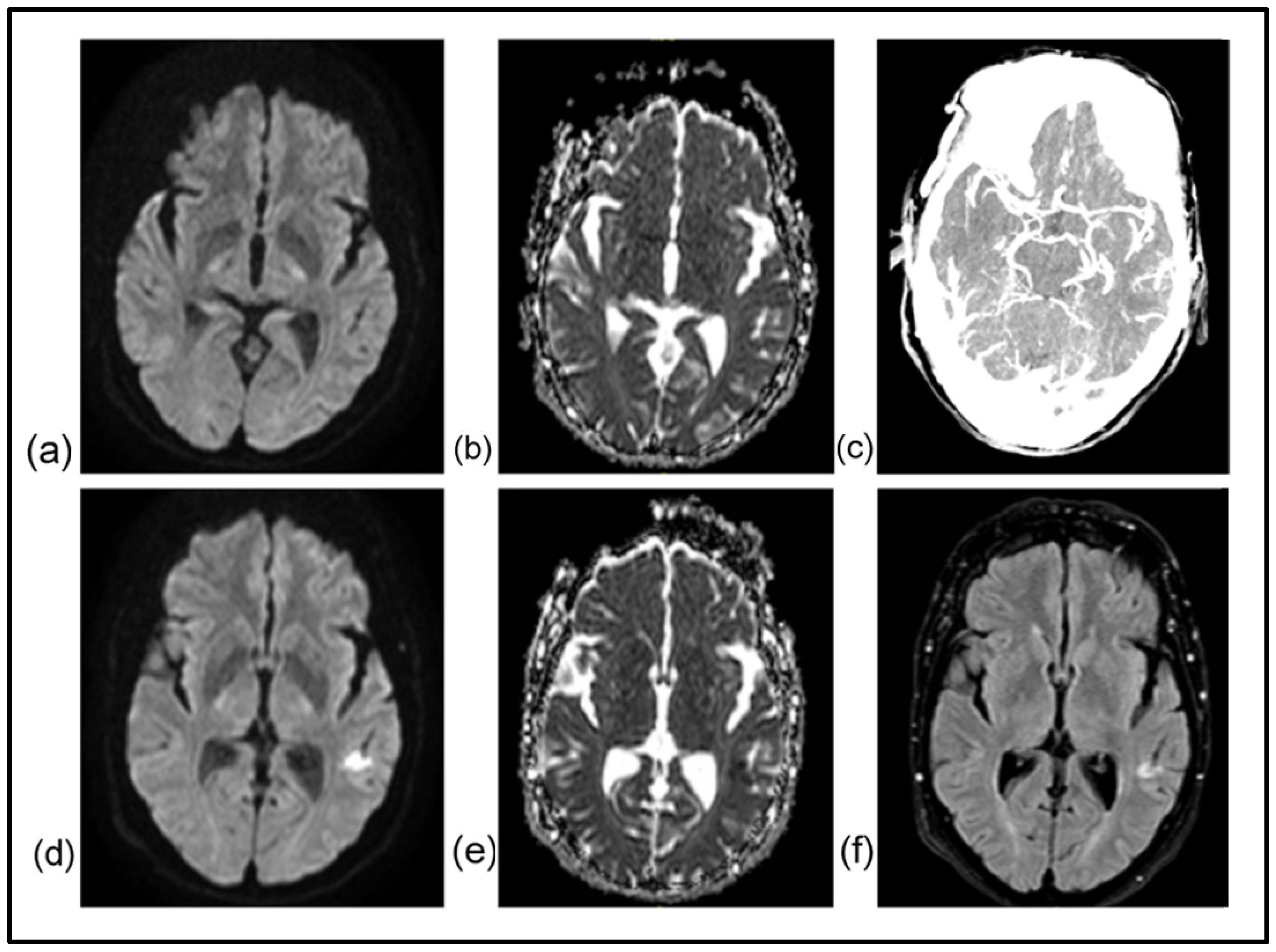 Limitations and Blind Spots of Diffusion-Weighted Imaging in the ...