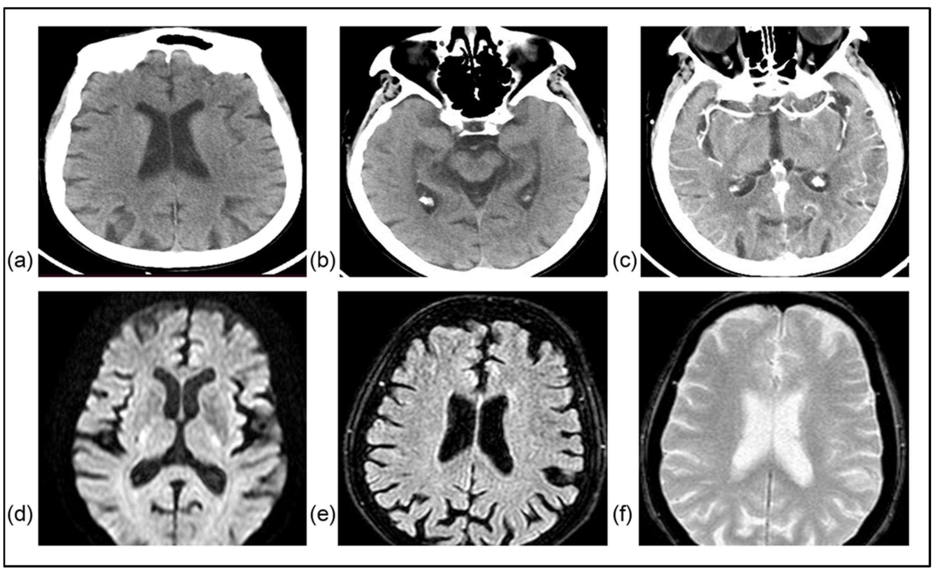 Limitations and Blind Spots of Diffusion-Weighted Imaging in the ...