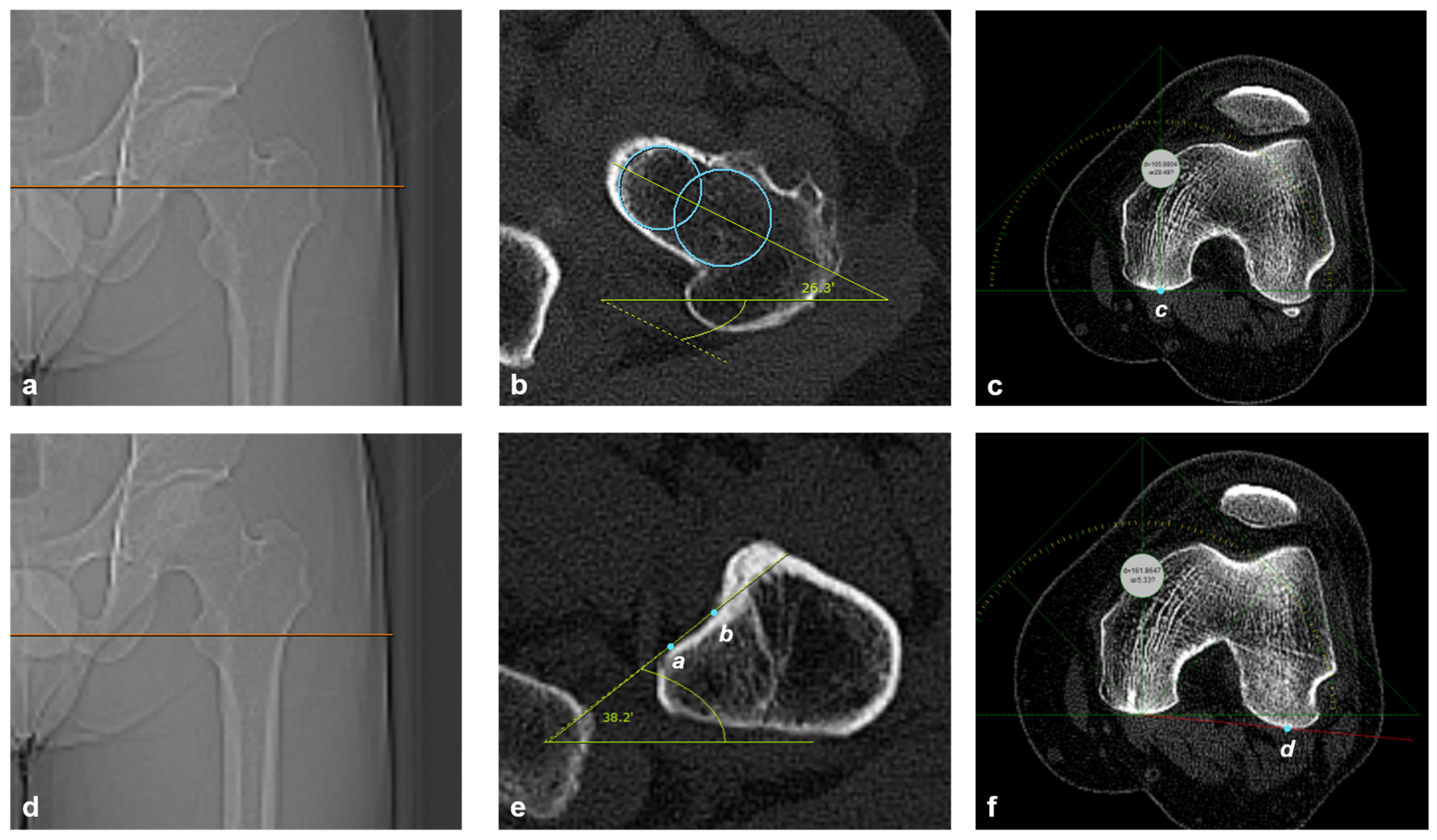 A Novel Potential Landmark for Intraoperative Estimation of Femoral ...