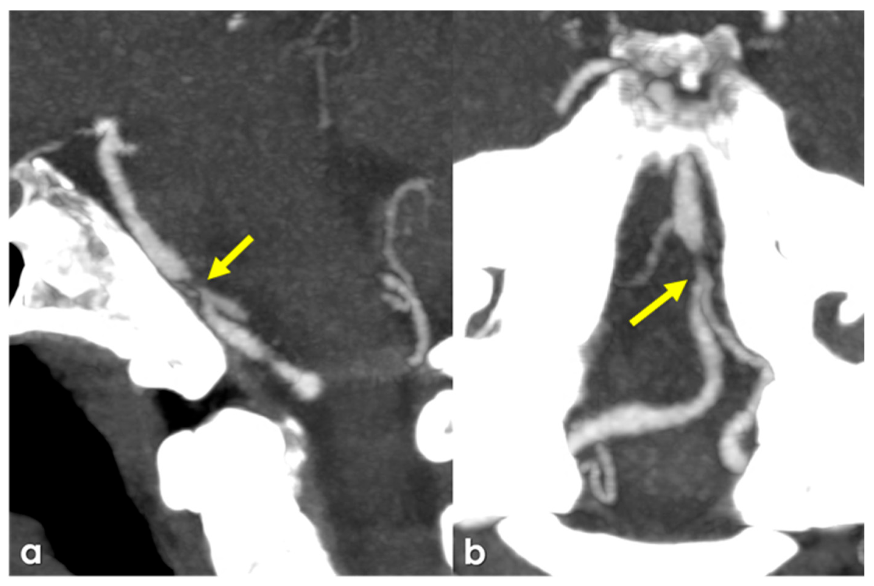 Parent Artery Disease-Related Stroke: What Is the Impact on ...