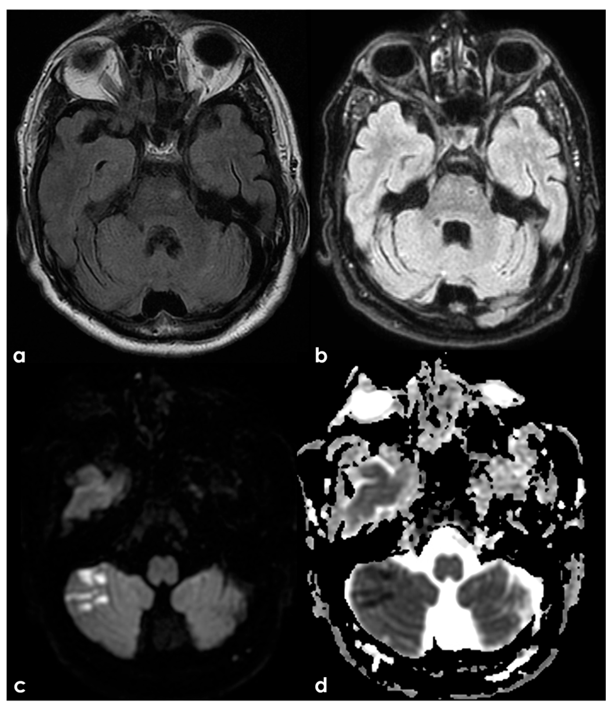 Parent Artery Disease-Related Stroke: What Is the Impact on ...