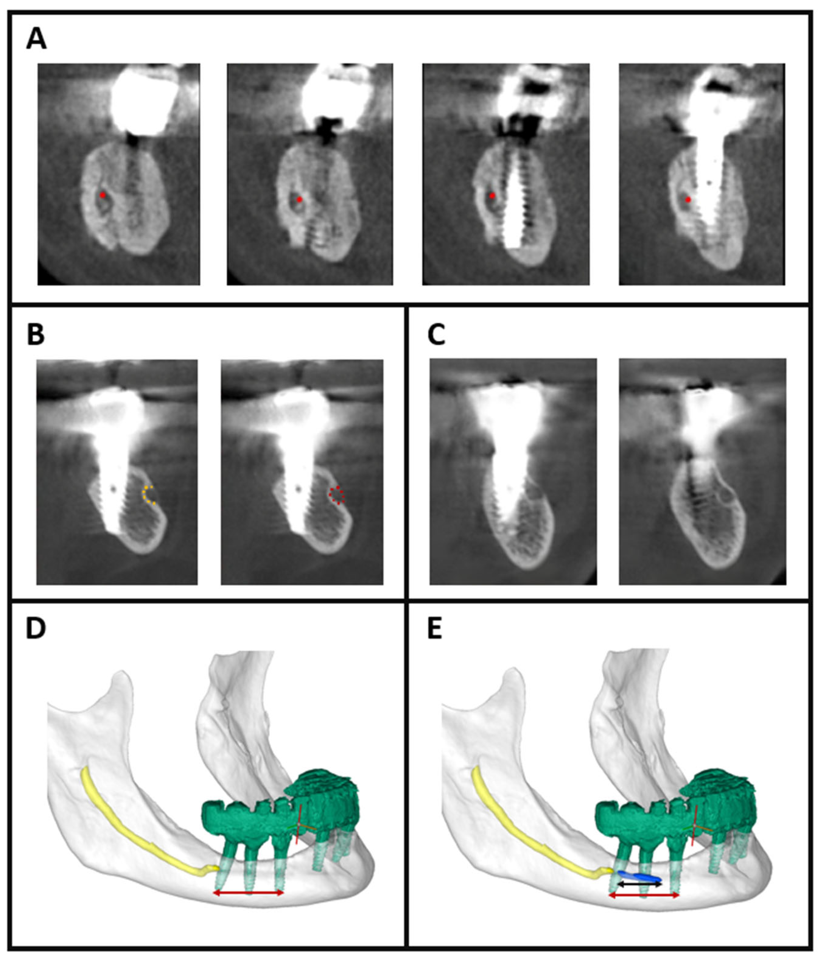 Computer-Assisted CBCT Evaluation of Inferior Alveolar Nerve Canal ...