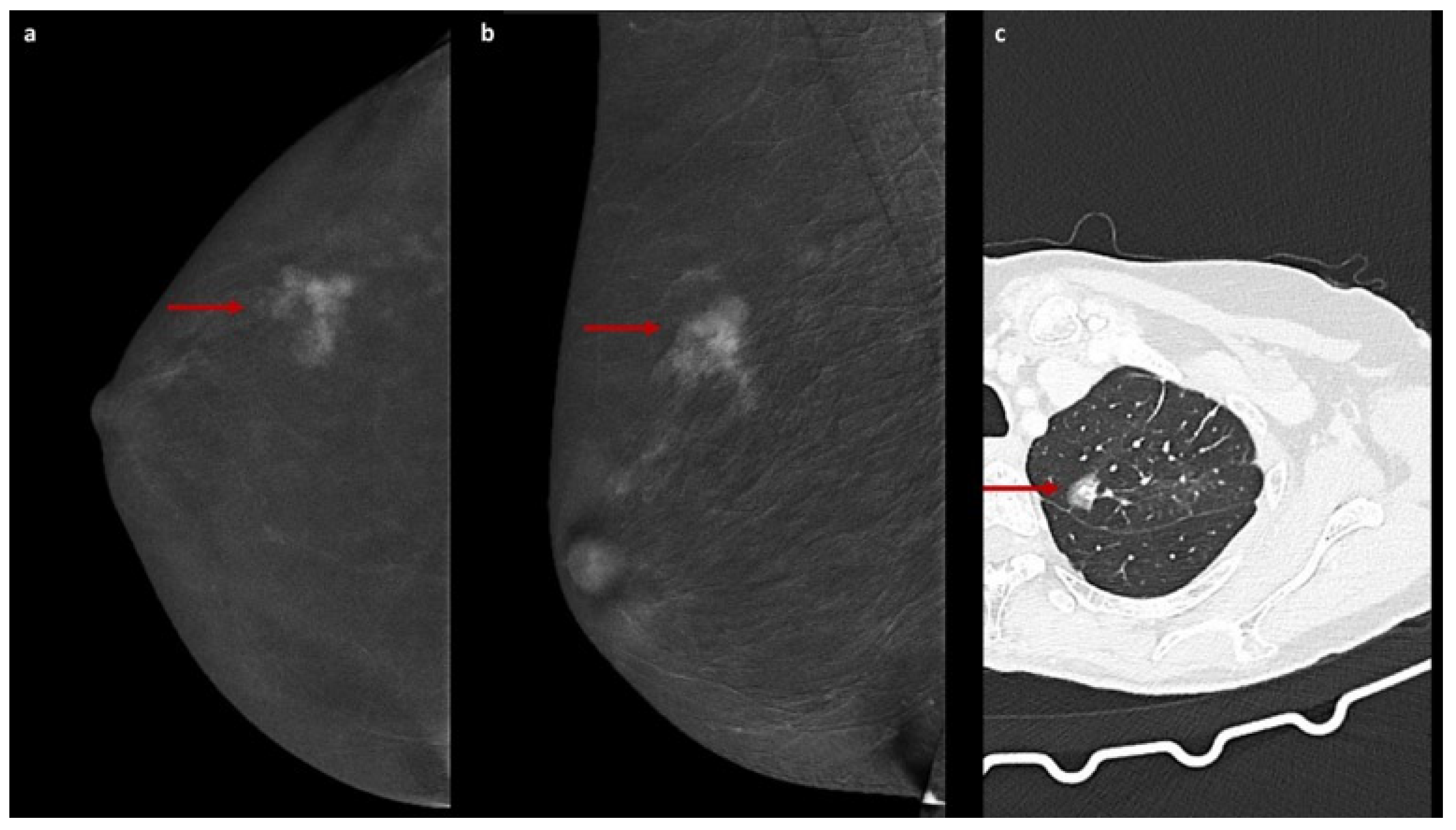 Ground-Glass Enhancement on Contrast-Enhanced Mammography: A CT ...