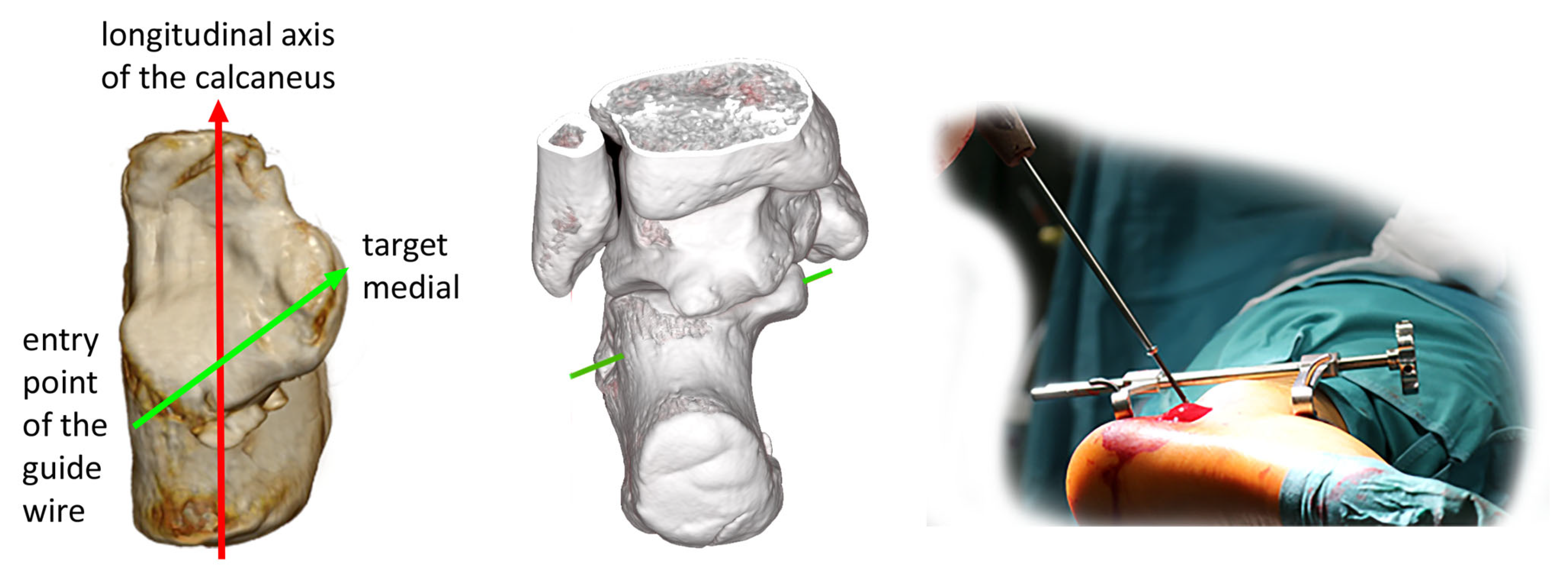 Safe and Accurate Sustentaculum Screw Placement in Minimally Invasive ...