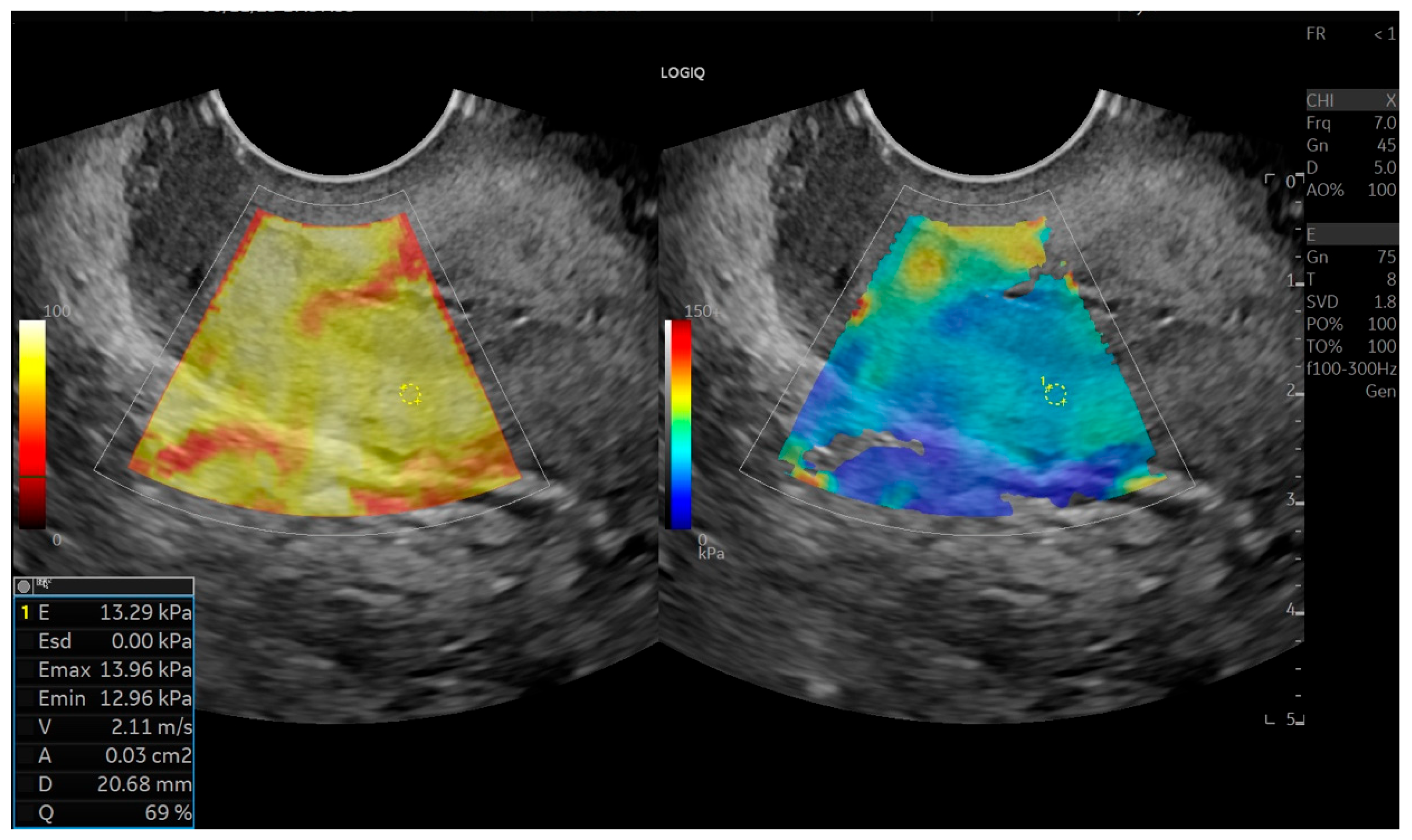 Evaluation of the Relationship Between Adenomyosis and Cervical ...