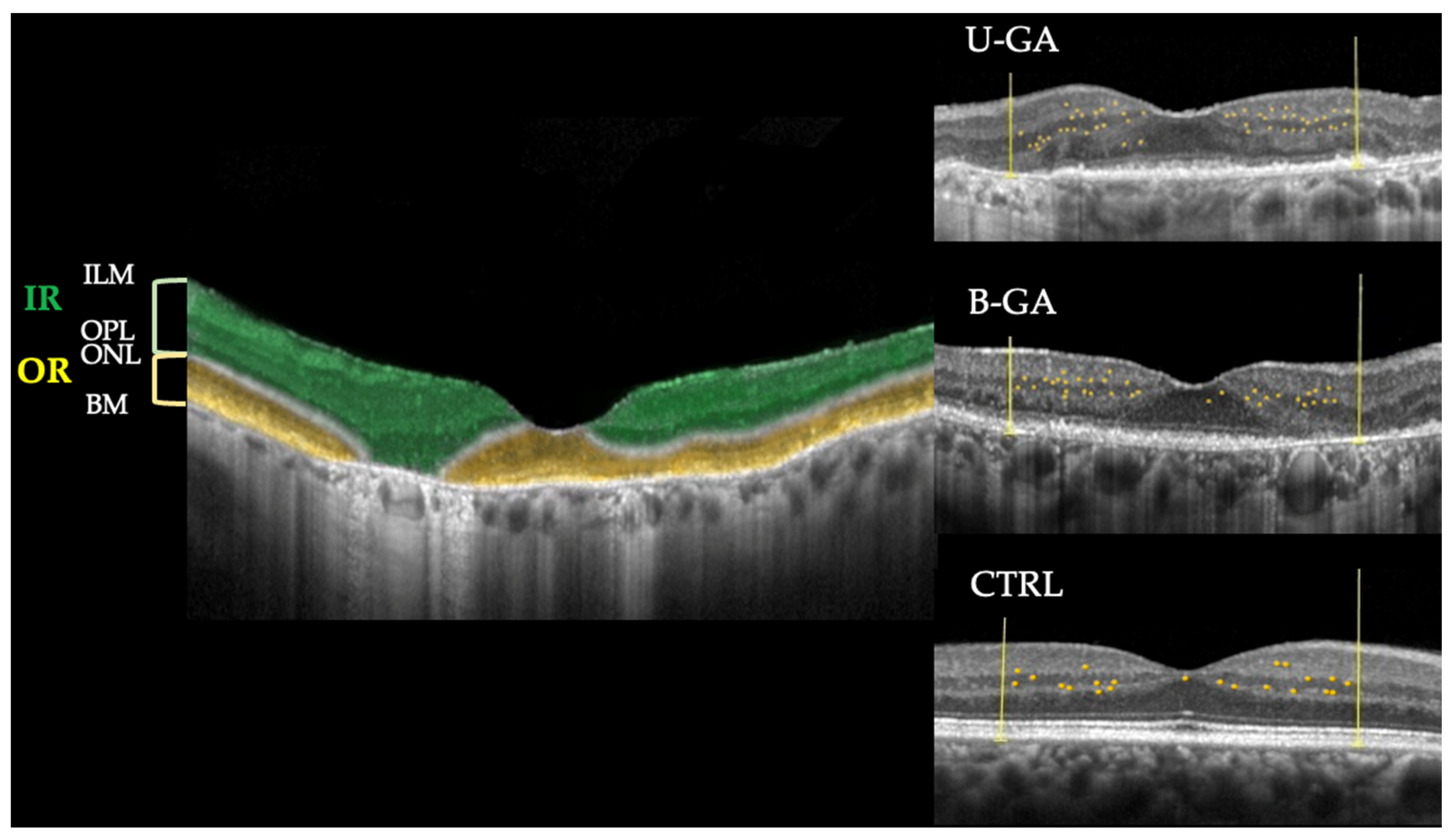 Inflammatory Hyperreflective Retinal Foci: An OCT Biomarker of ...