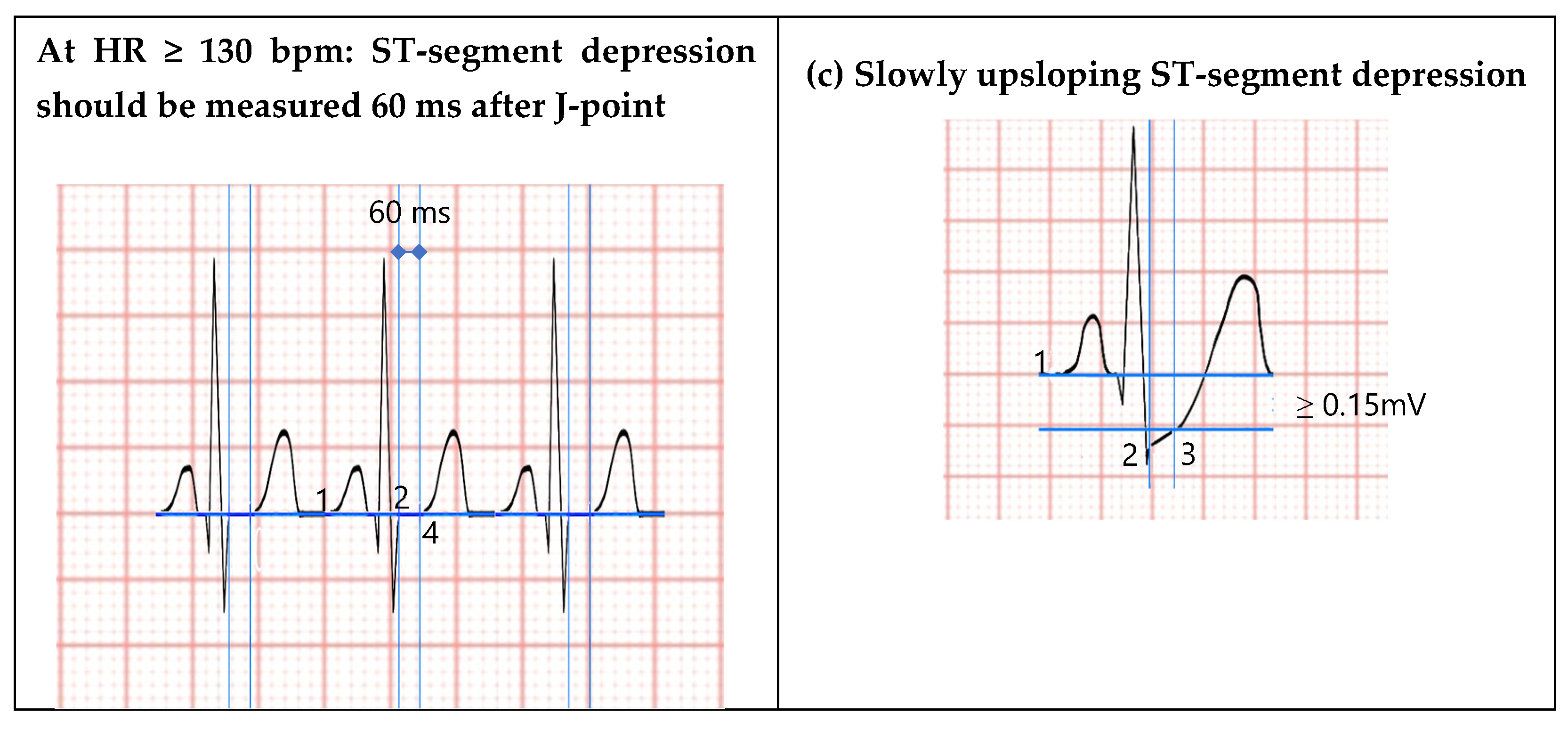 Exercise Stress Testing in Clinical Cardiology: A Practical Guide to ...