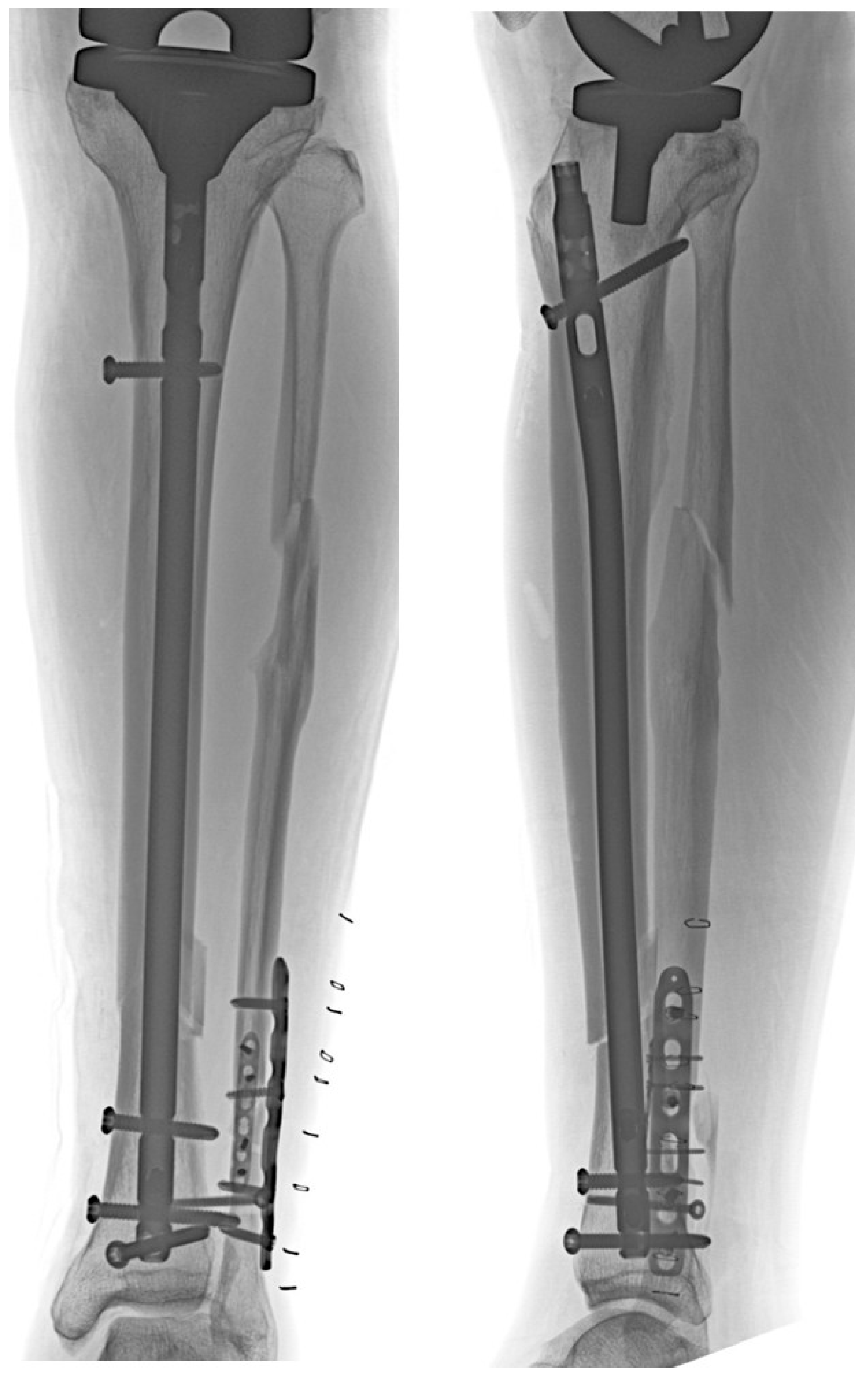 Radiographic Verification of the Feasibility of Intramedullary Nailing ...