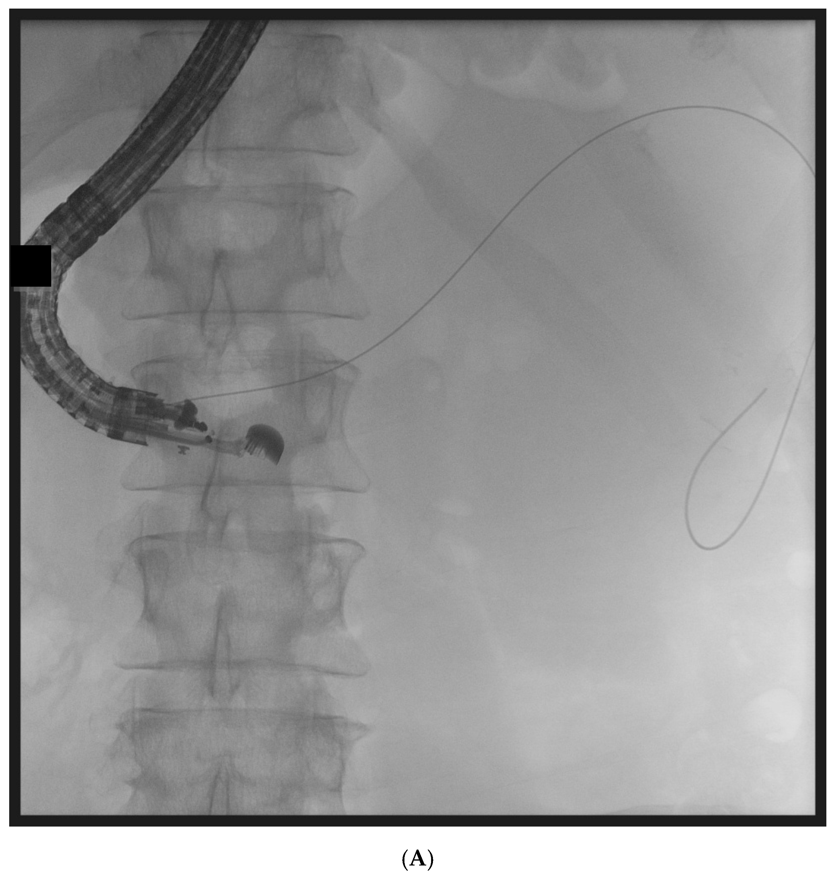 The Use of Direct Endoscopic Necrosectomy During Endoscopic Drainage of ...