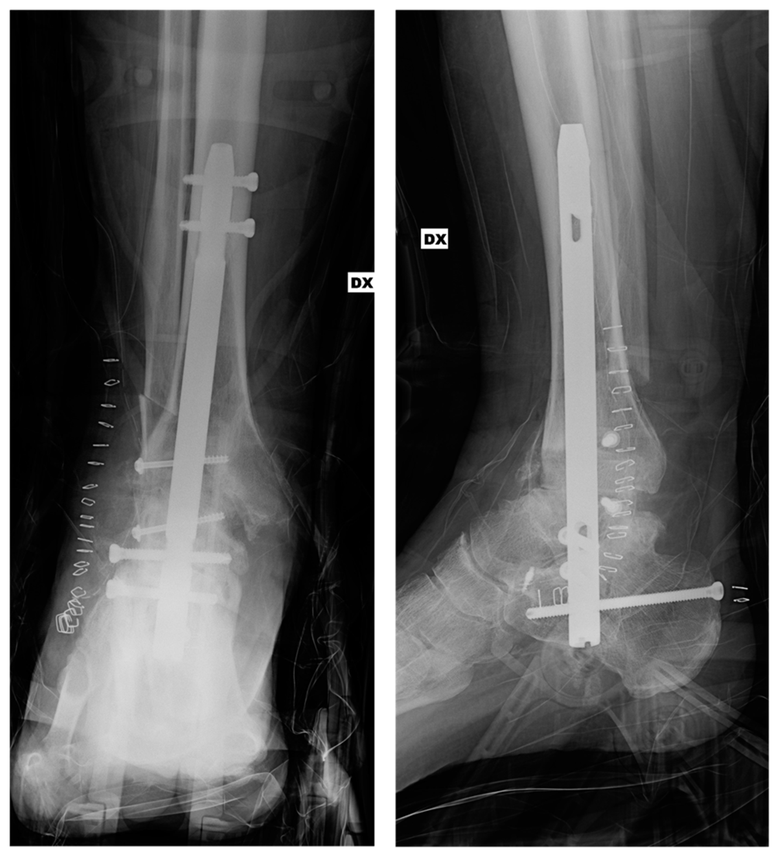 Revision of Tibiotalar Arthrodesis Nonunion Using Intramedullary ...