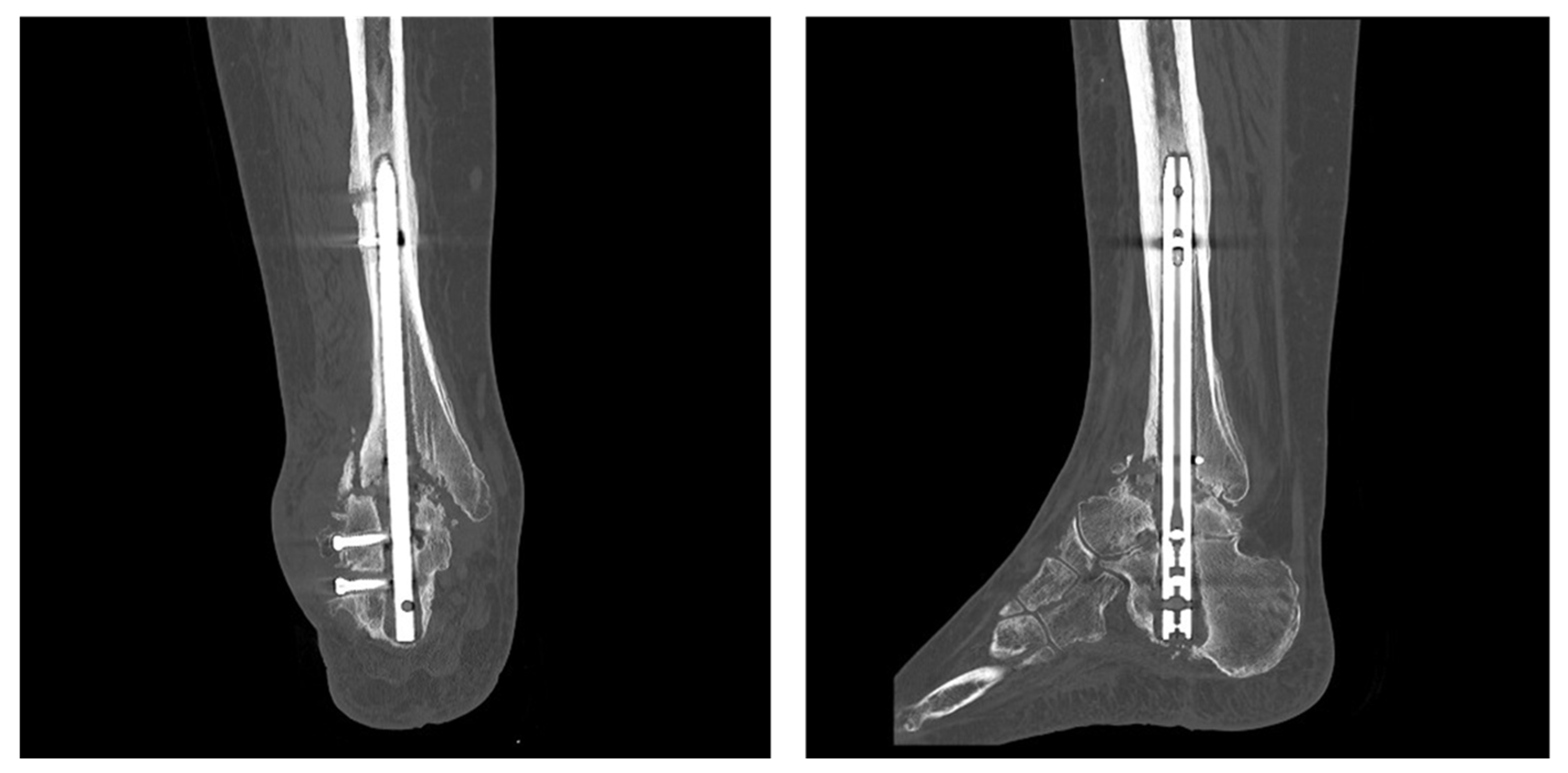 Revision of Tibiotalar Arthrodesis Nonunion Using Intramedullary ...