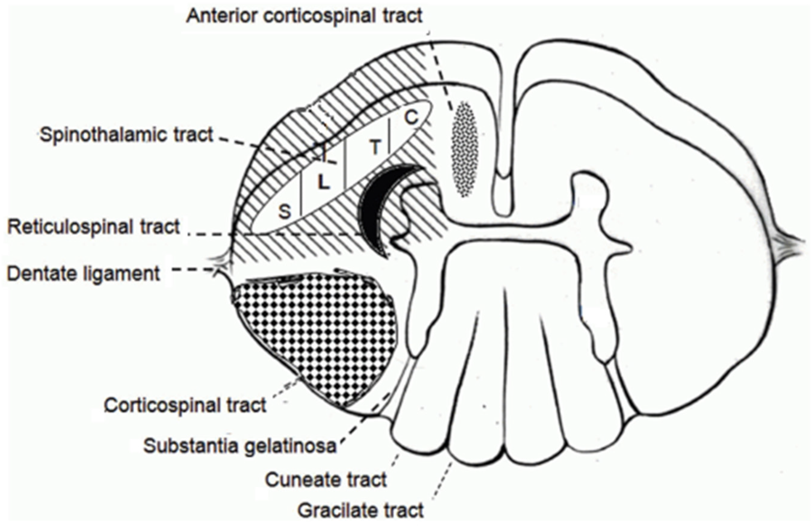Open Anterolateral Cordotomy for Cancer Pain: Indication, Efficacy, and ...