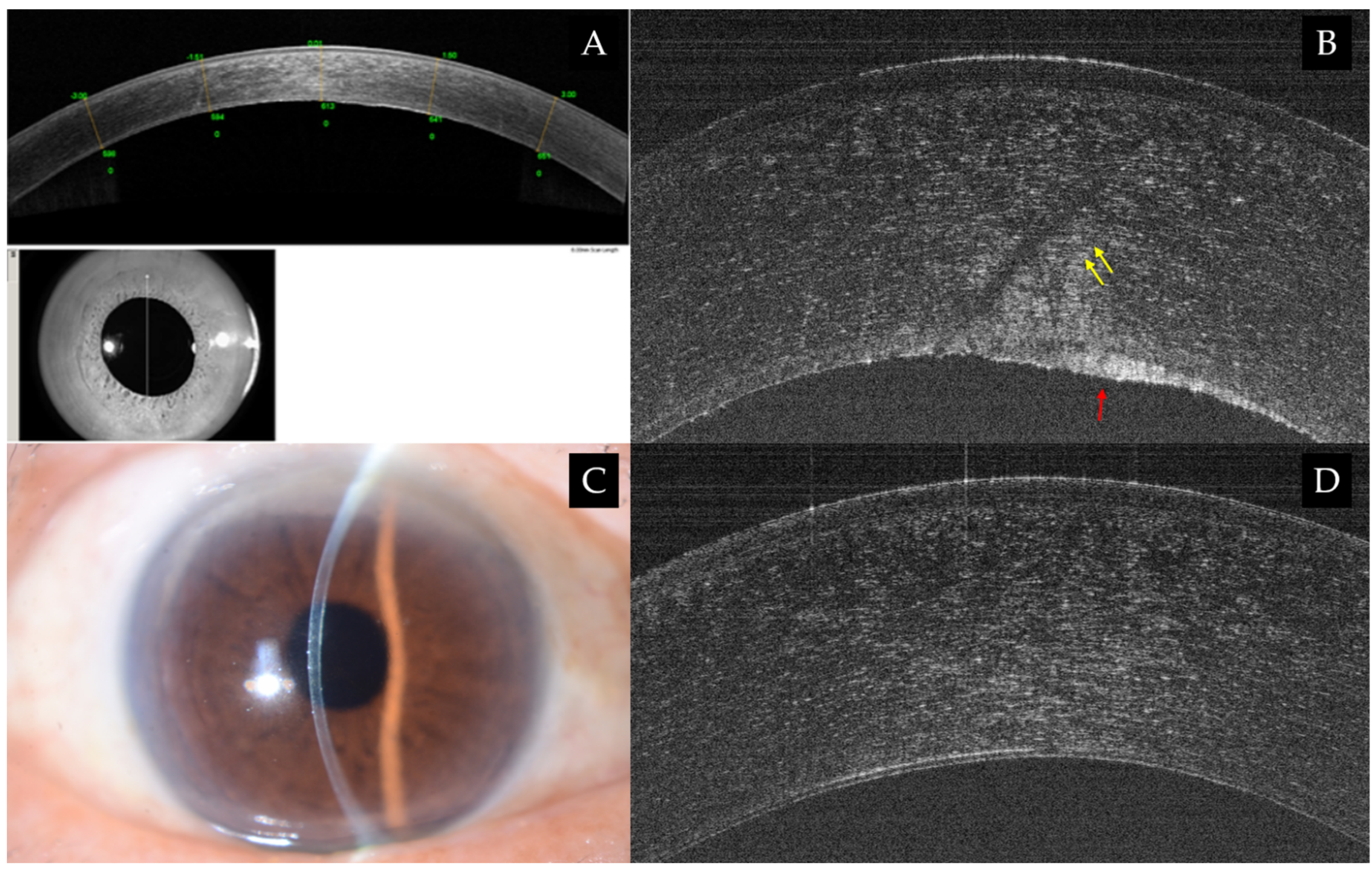 Anterior Segment Optical Coherence Tomography with Angiography for the ...