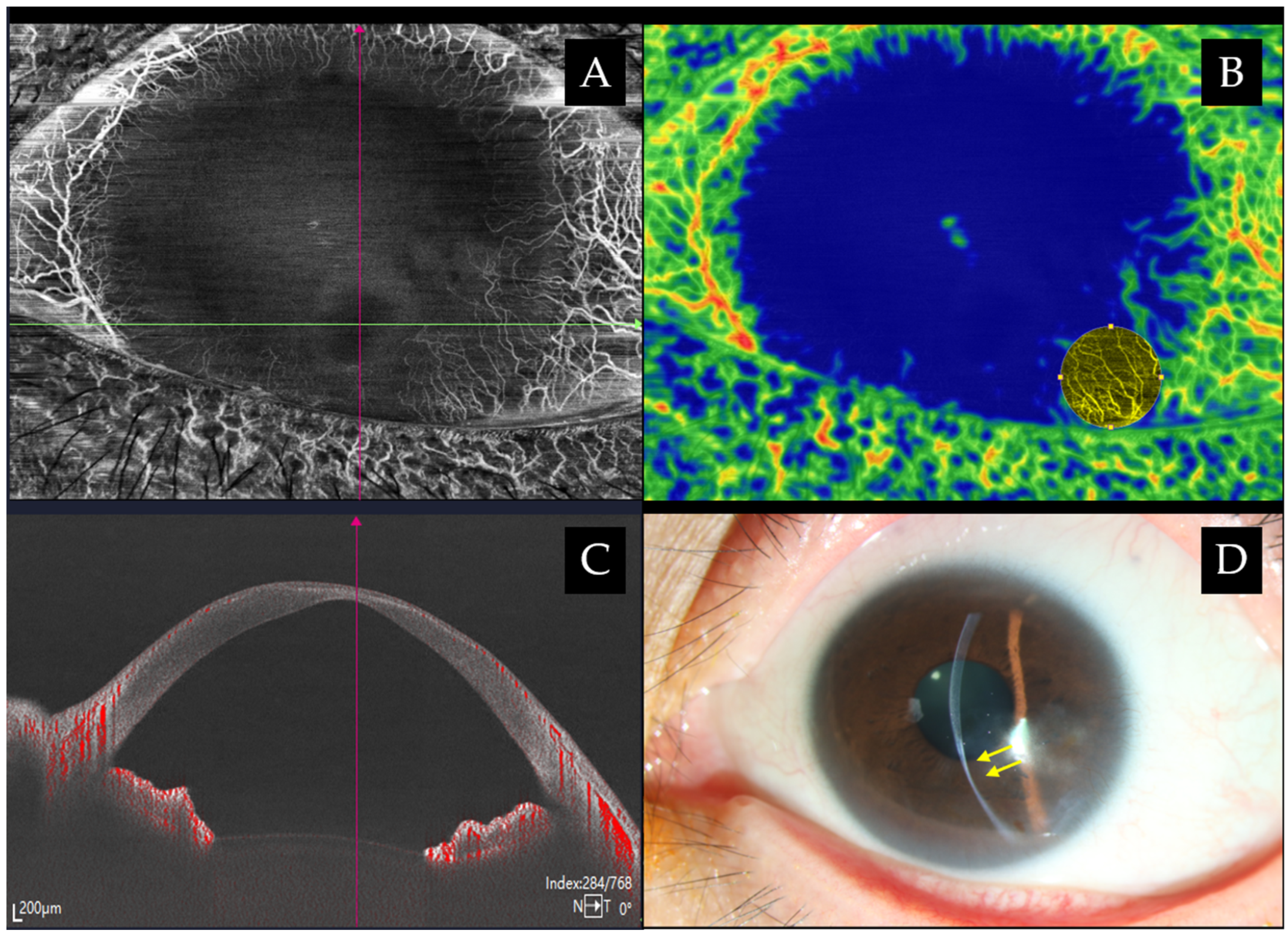 Anterior Segment Optical Coherence Tomography with Angiography for the ...
