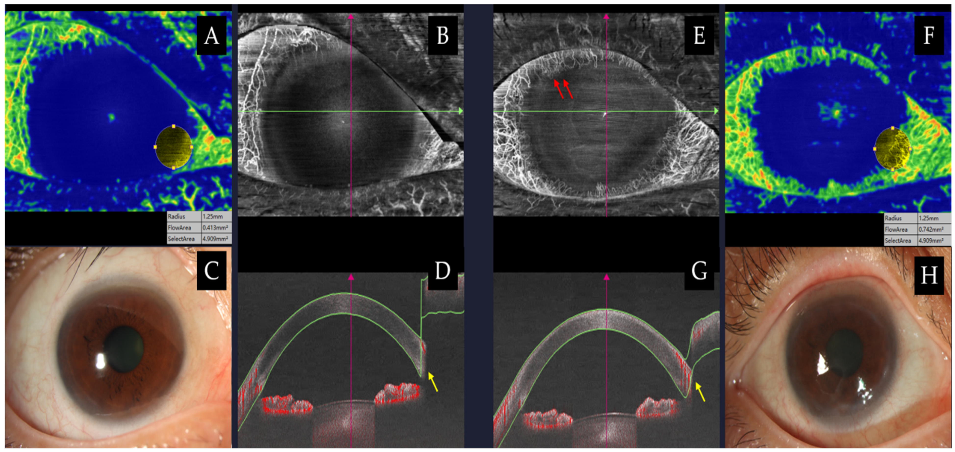Anterior Segment Optical Coherence Tomography with Angiography for the ...