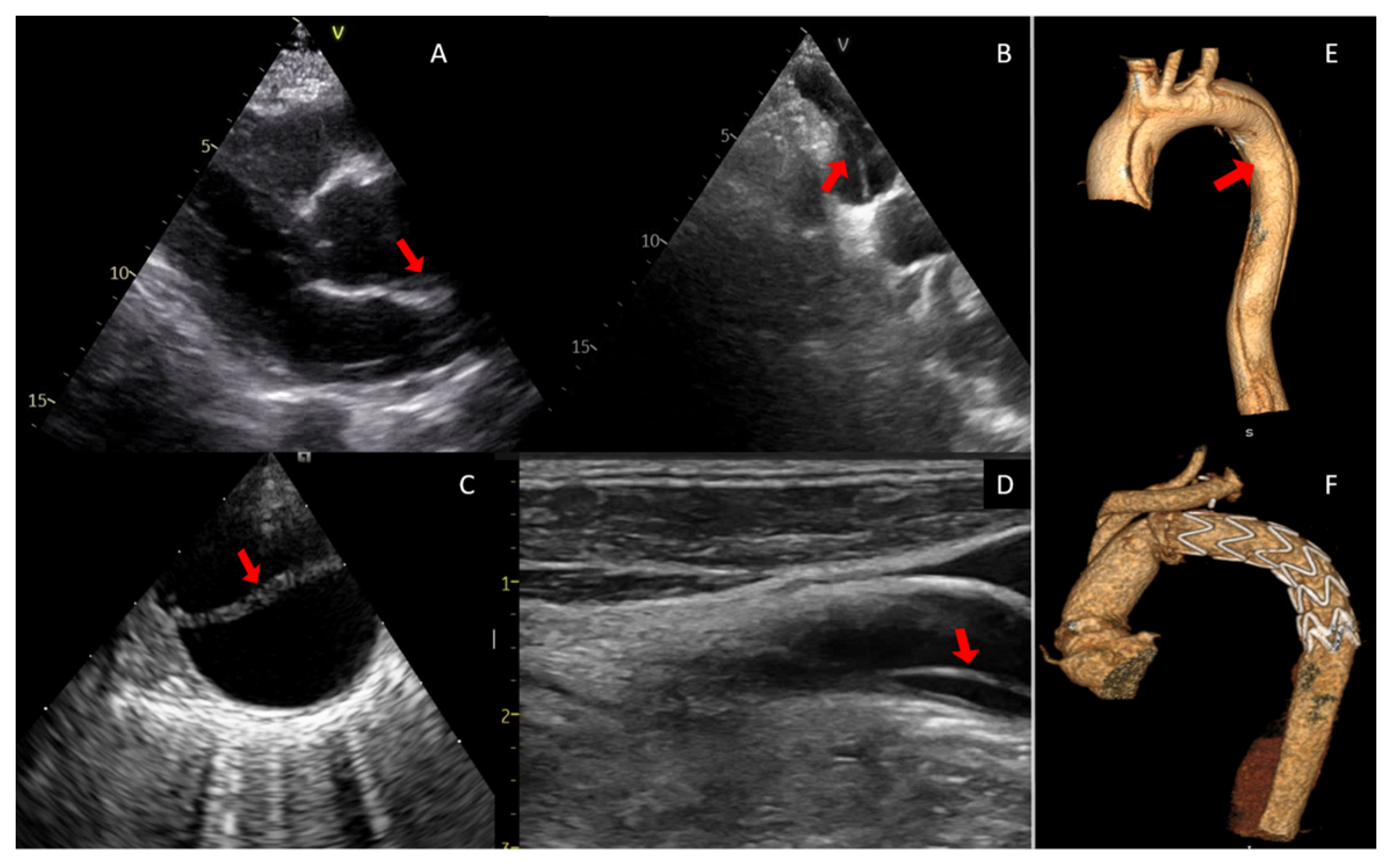 Type A Aortic Dissection: From Diagnosis to Cardiac Rehabilitation
