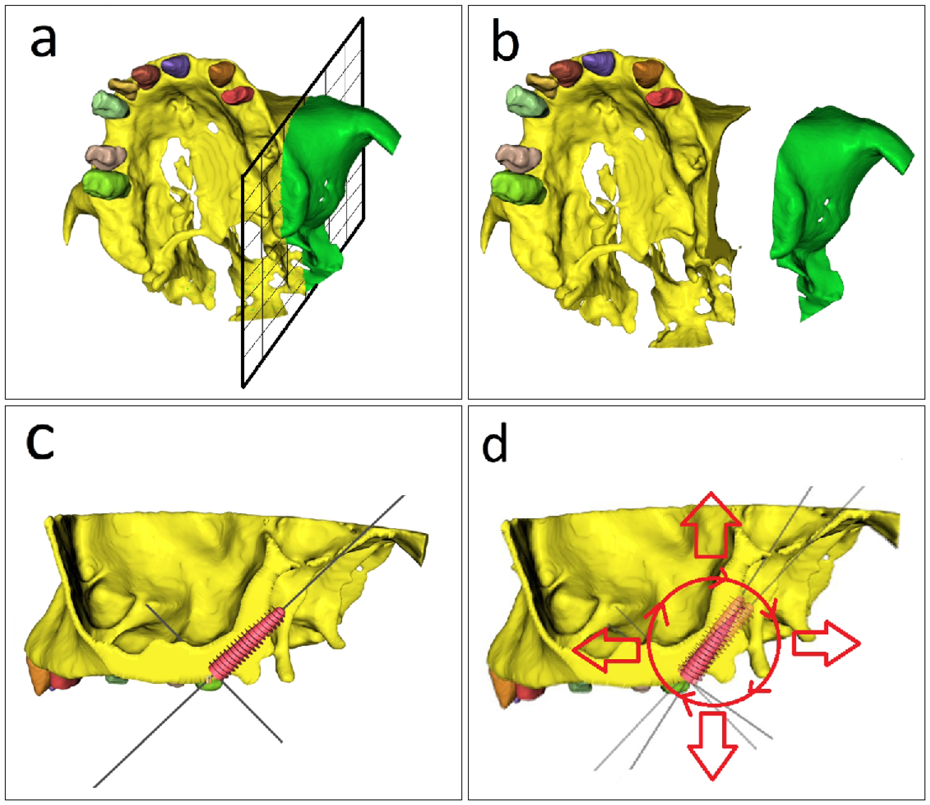 A Segmentation-Assisted Three-Dimensional Planning Workflow for Static ...