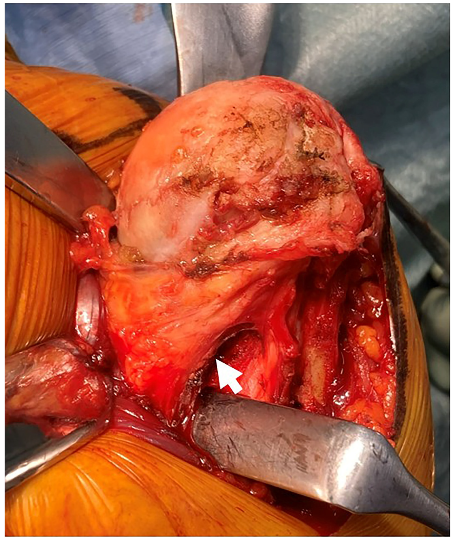 A Subscapularis-Sparing Modification of the Deltopectoral Approach for ...