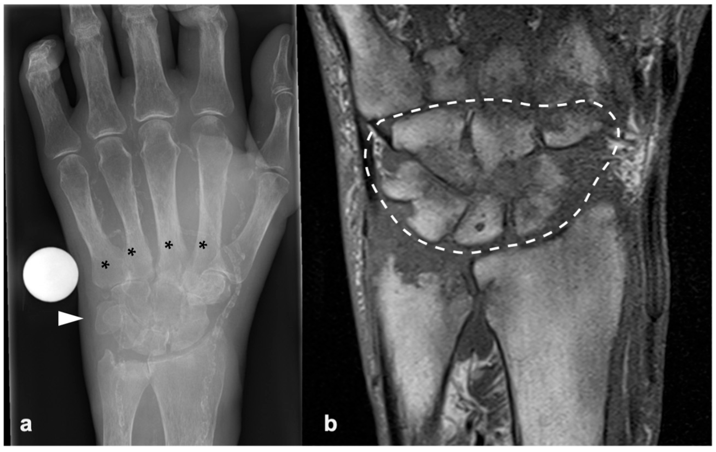 Destructive Mold Osteomyelitis of the Wrist Caused by Scedosporium ...