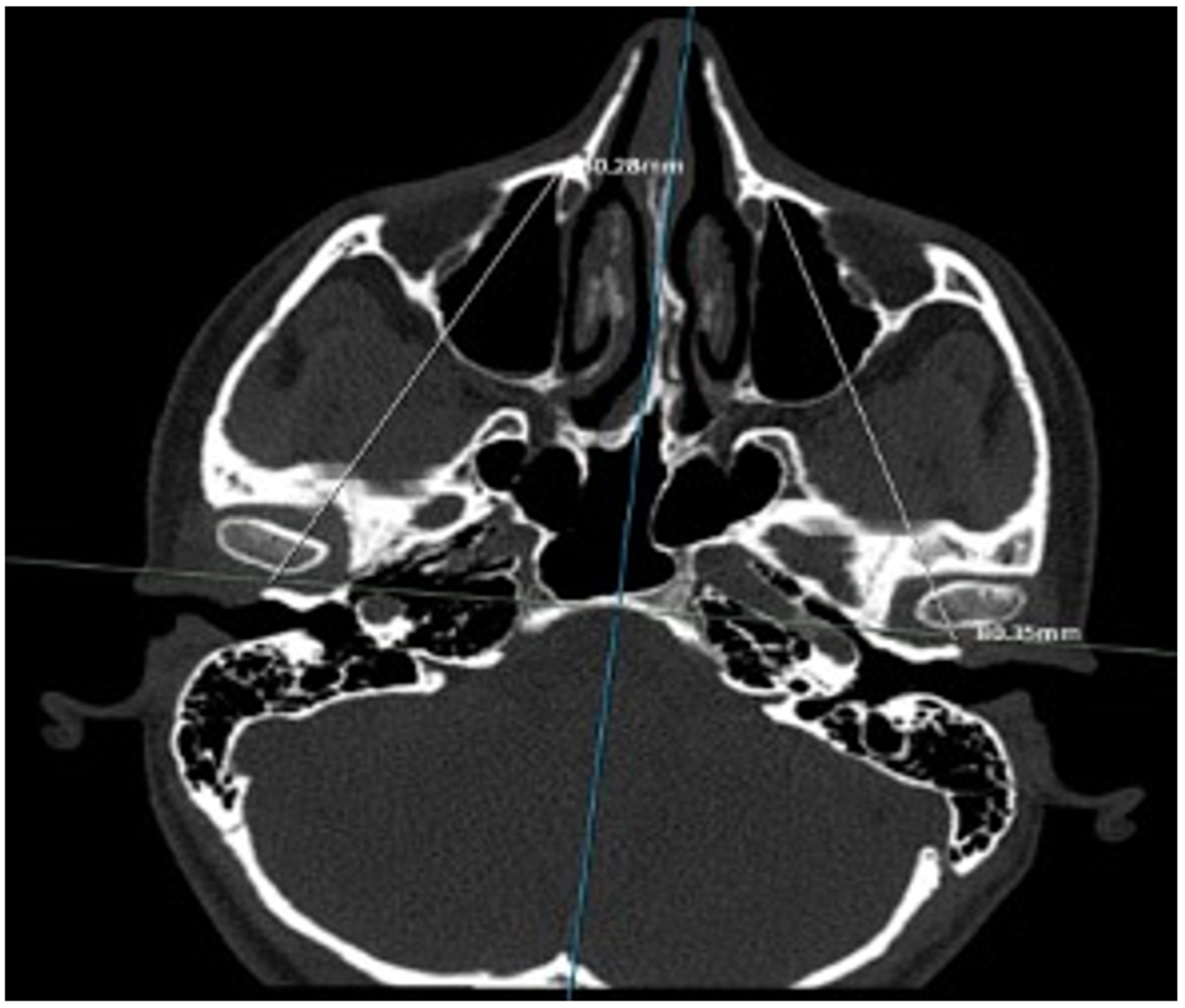 Association Between Anterior Maxillary Sinus Wall Position and Nasal ...