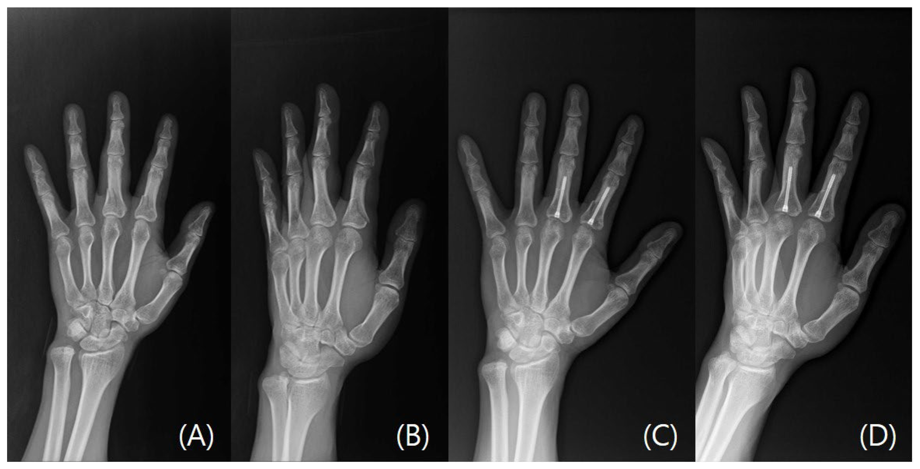 Minimally Invasive Antegrade Fixation of Proximal Phalangeal Fractures ...
