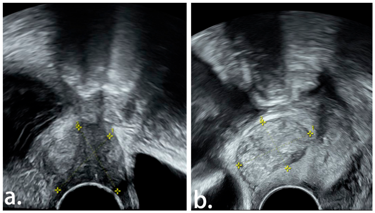 Ultrasound–Clinical Machine Learning Models for Differentiating Early ...