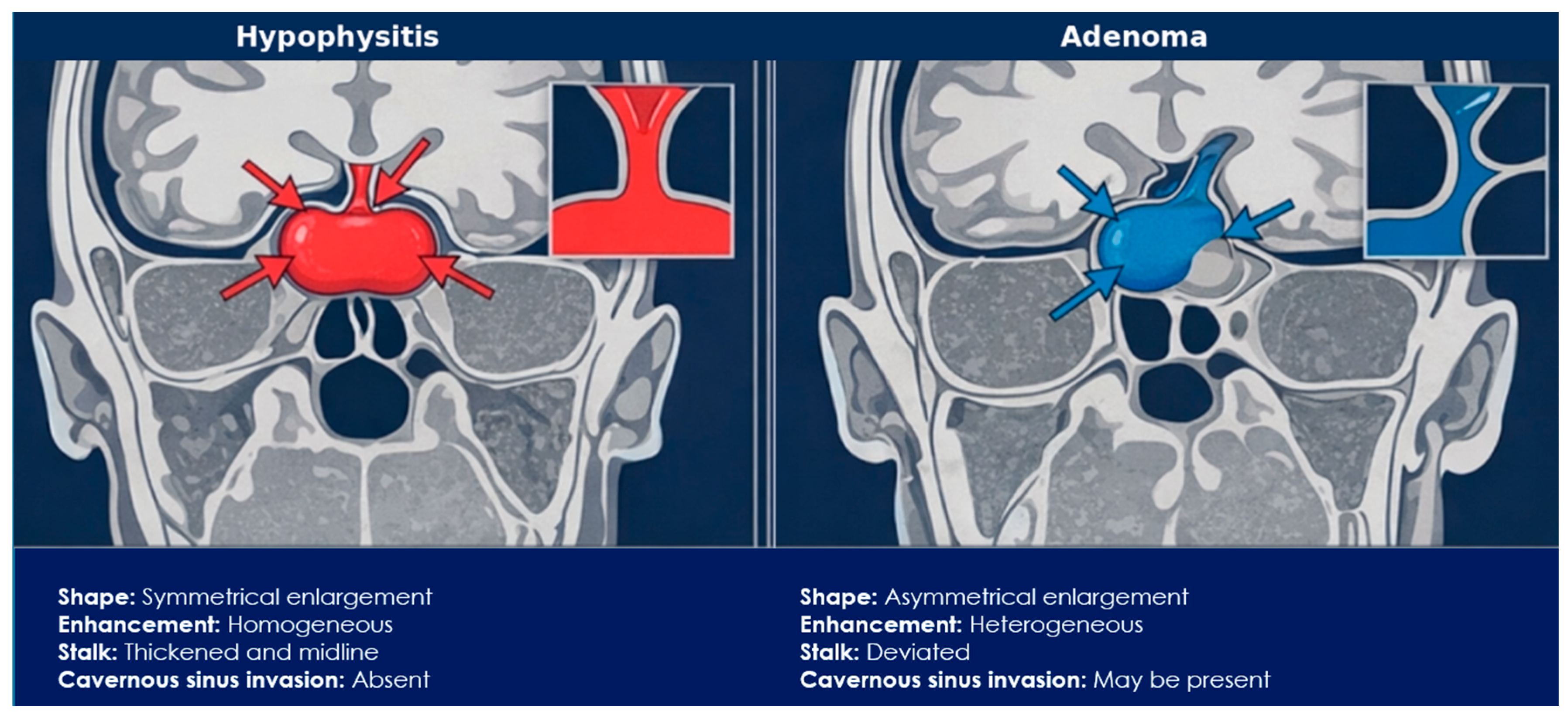 Immune-Mediated Hypophysitis: An Updated Review