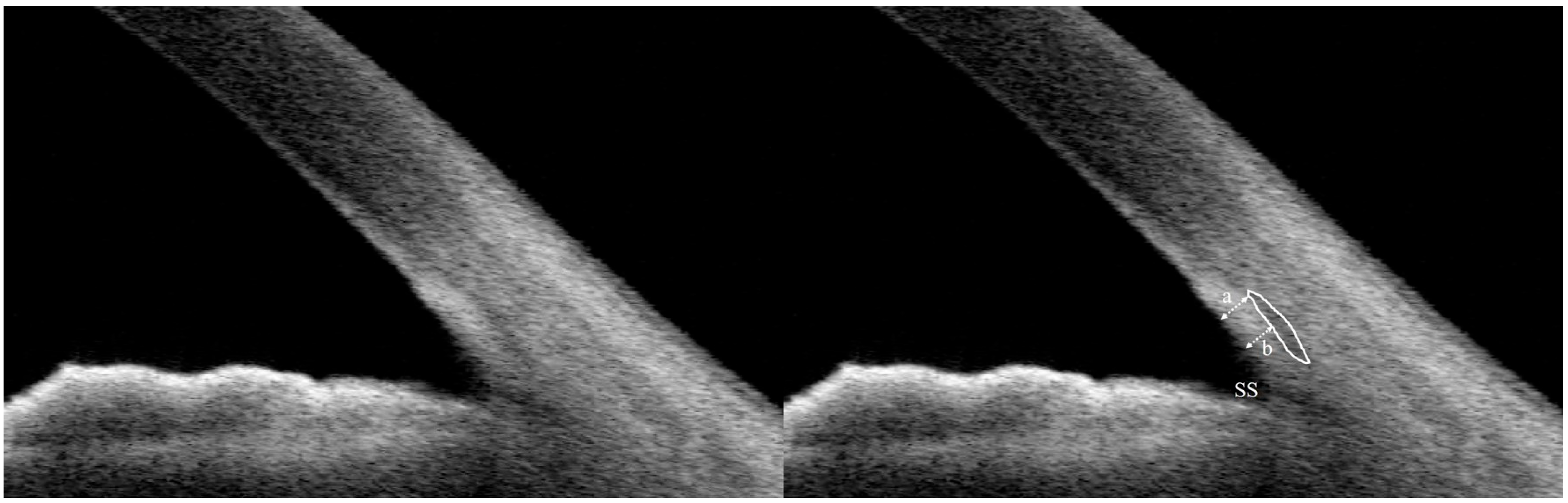 Trabecular Meshwork Thickness Measured by Swept-Source AS-OCT as a ...