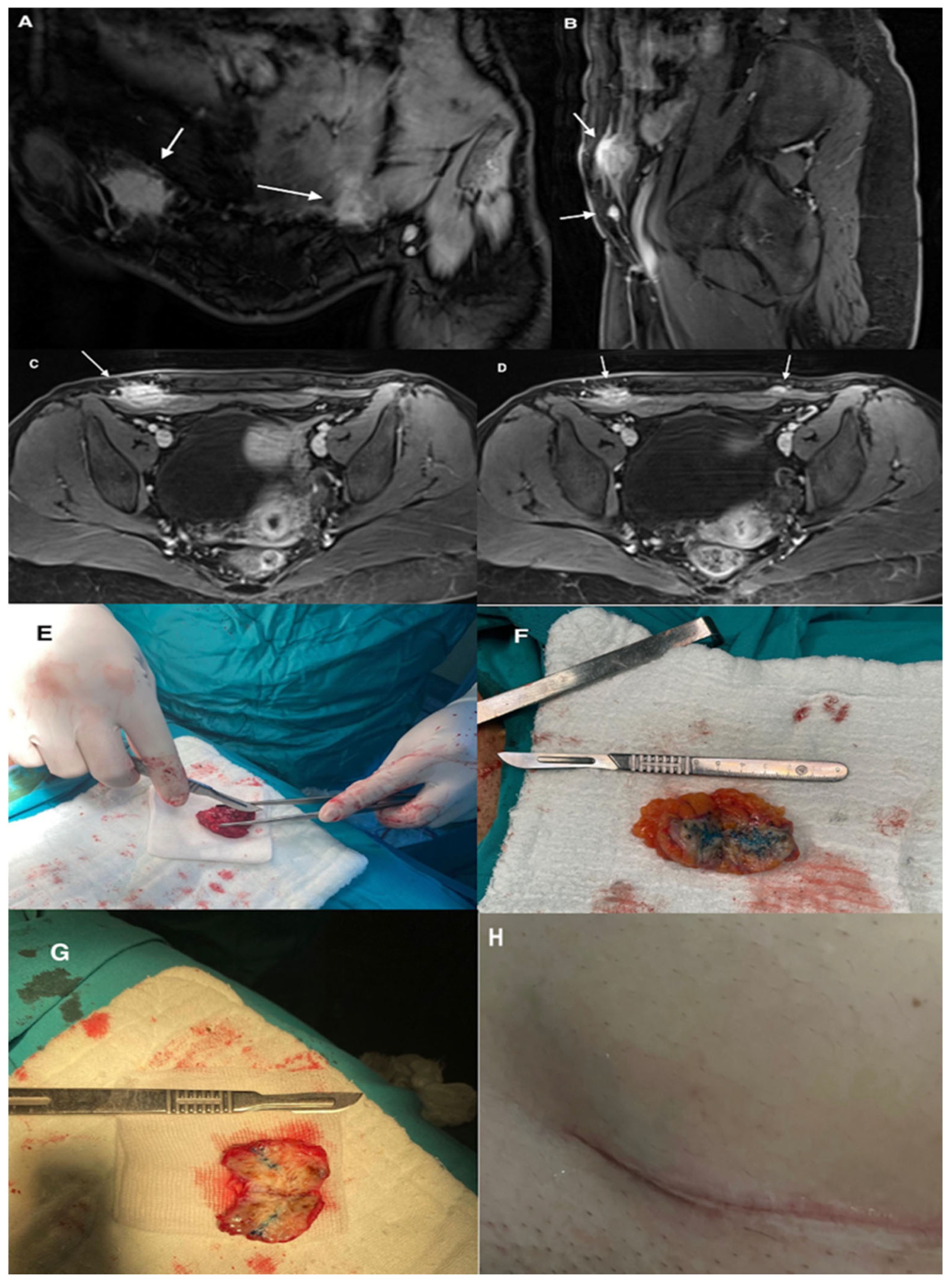Uncommon Presentations of Endometriosis: Clinicopathological Features ...