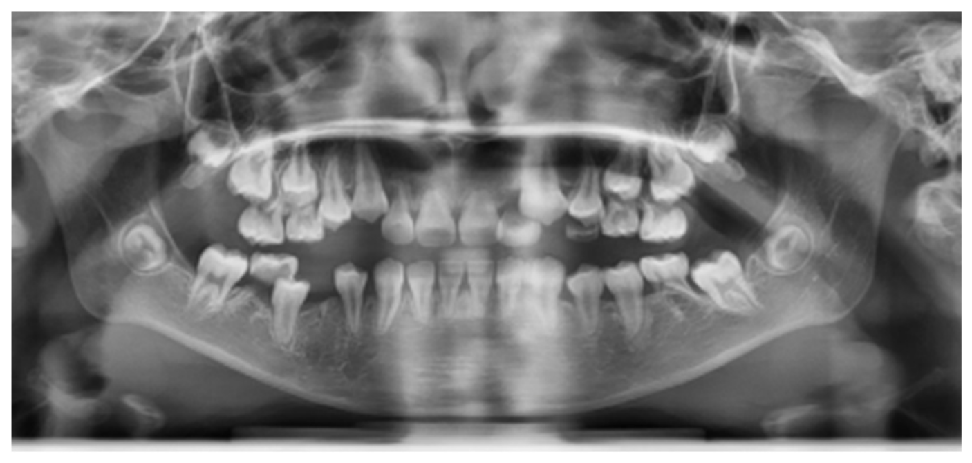 Orthodontic Treatment in Idiopathic Root Resorption: A Narrative Review ...