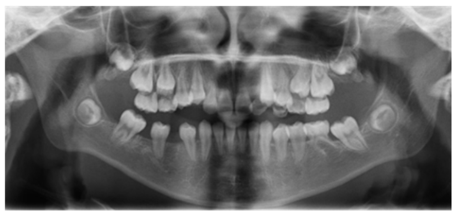 Orthodontic Treatment in Idiopathic Root Resorption: A Narrative Review ...