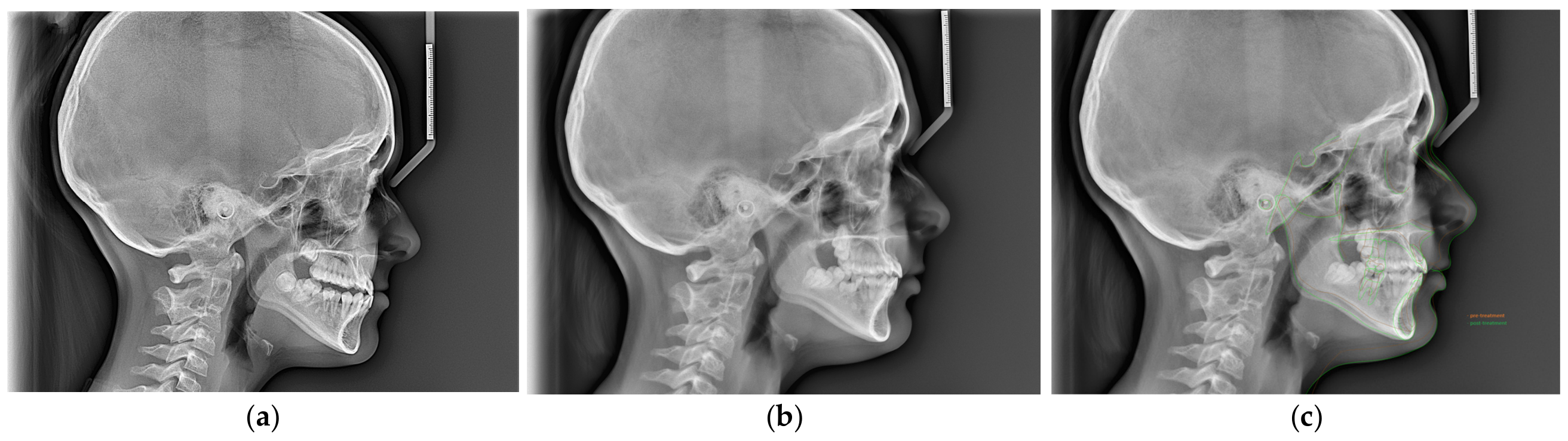 Orthodontic Treatment in Idiopathic Root Resorption: A Narrative Review ...