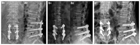 Risk Factors for Postoperative Complications in Different Fusion ...