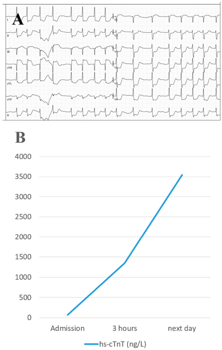 Clinical Gray Zones of Cardiac Troponin Interpretation in the Emergency ...